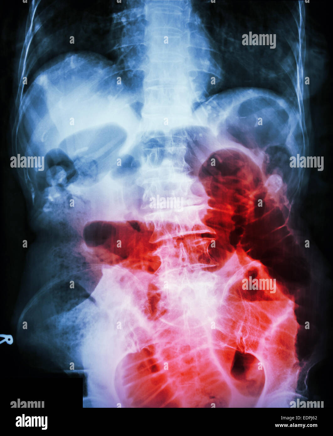 Small bowel obstruction hi-res stock photography and images - Alamy