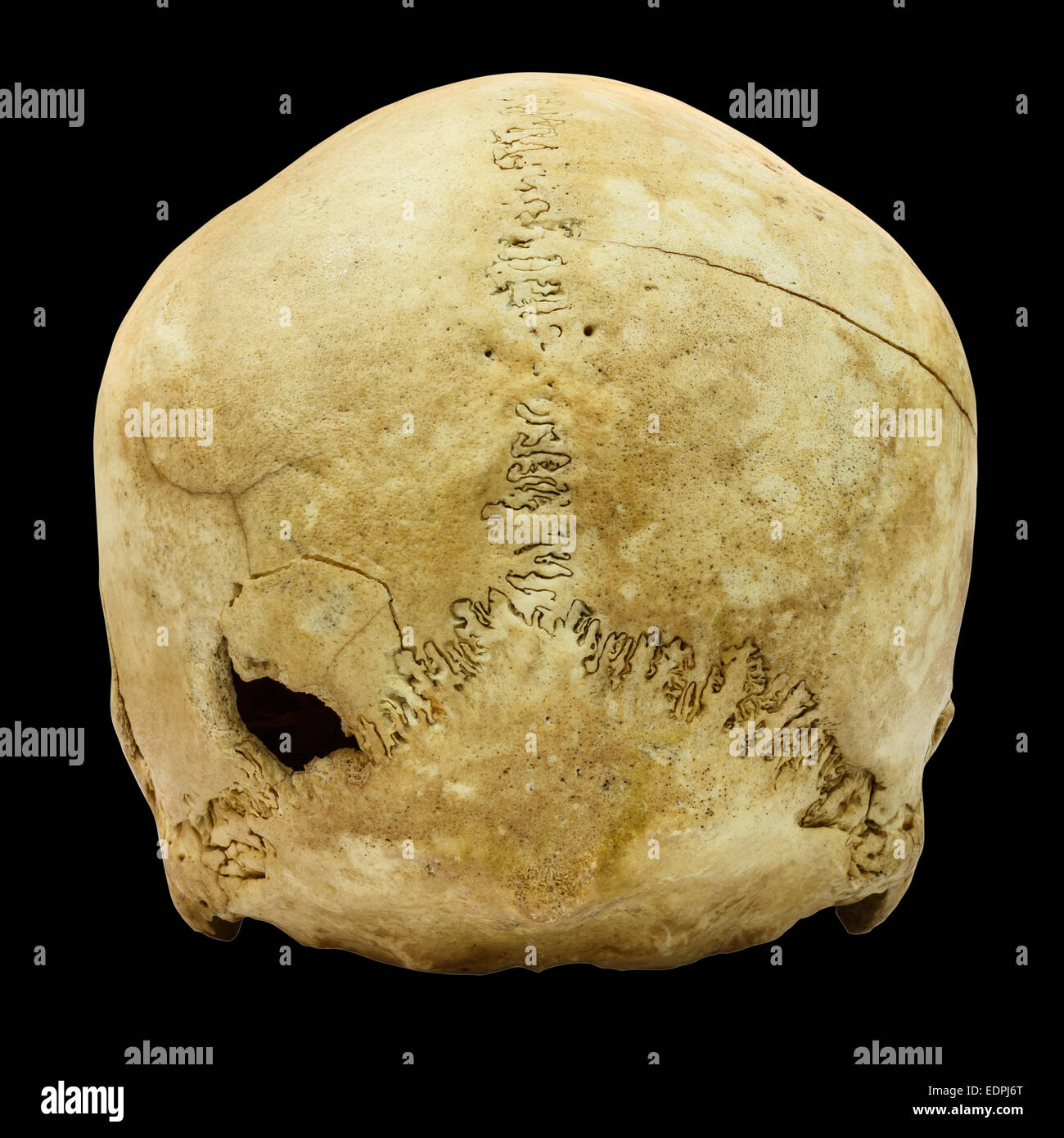 Human Skull Fracture (backside) (Mongoloid,Asian) on isolated ...
