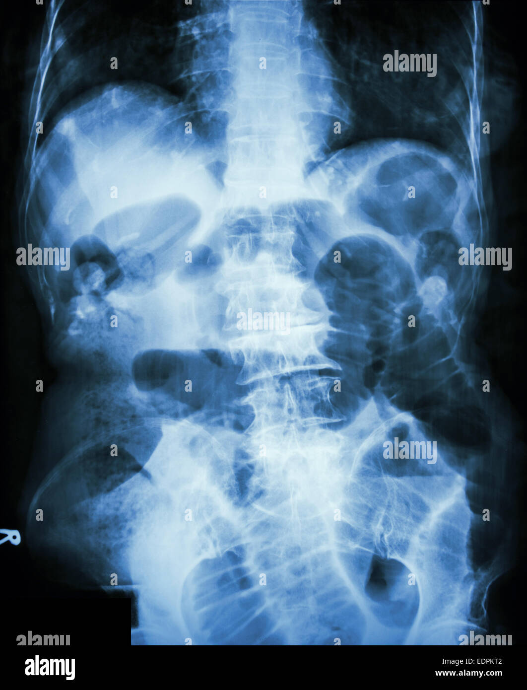 Small bowel obstruction. Film X-ray abdomen supine : show small bowel ...