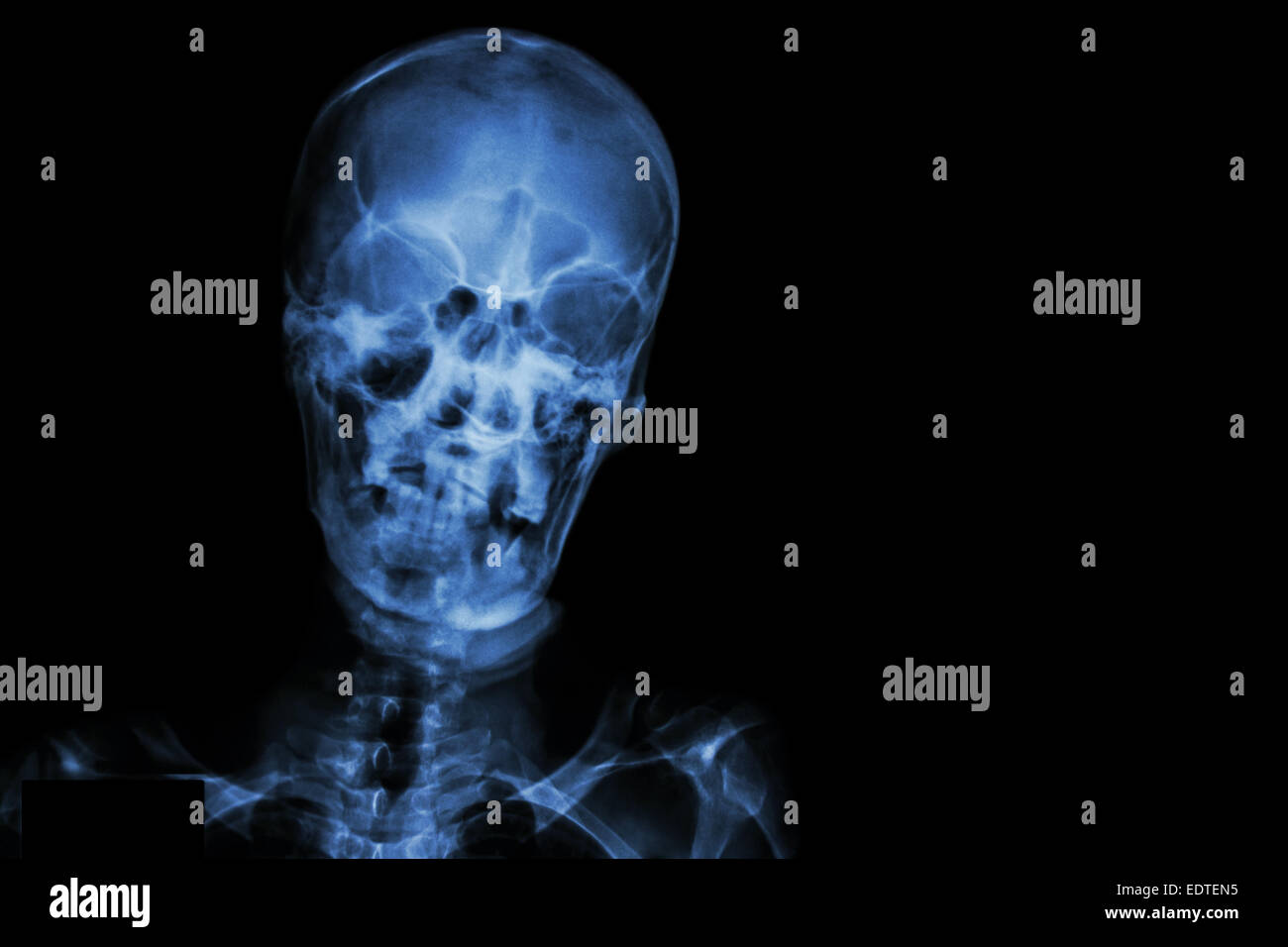 Human skull right side hi-res stock photography and images - Alamy