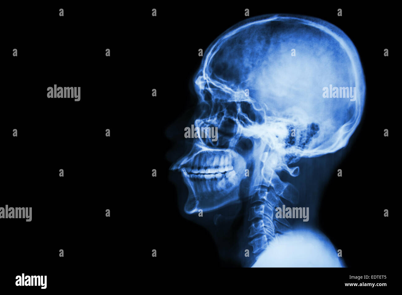 X Ray Skull Side X Ray Asian Skull And Blank Area At Left Side Stock