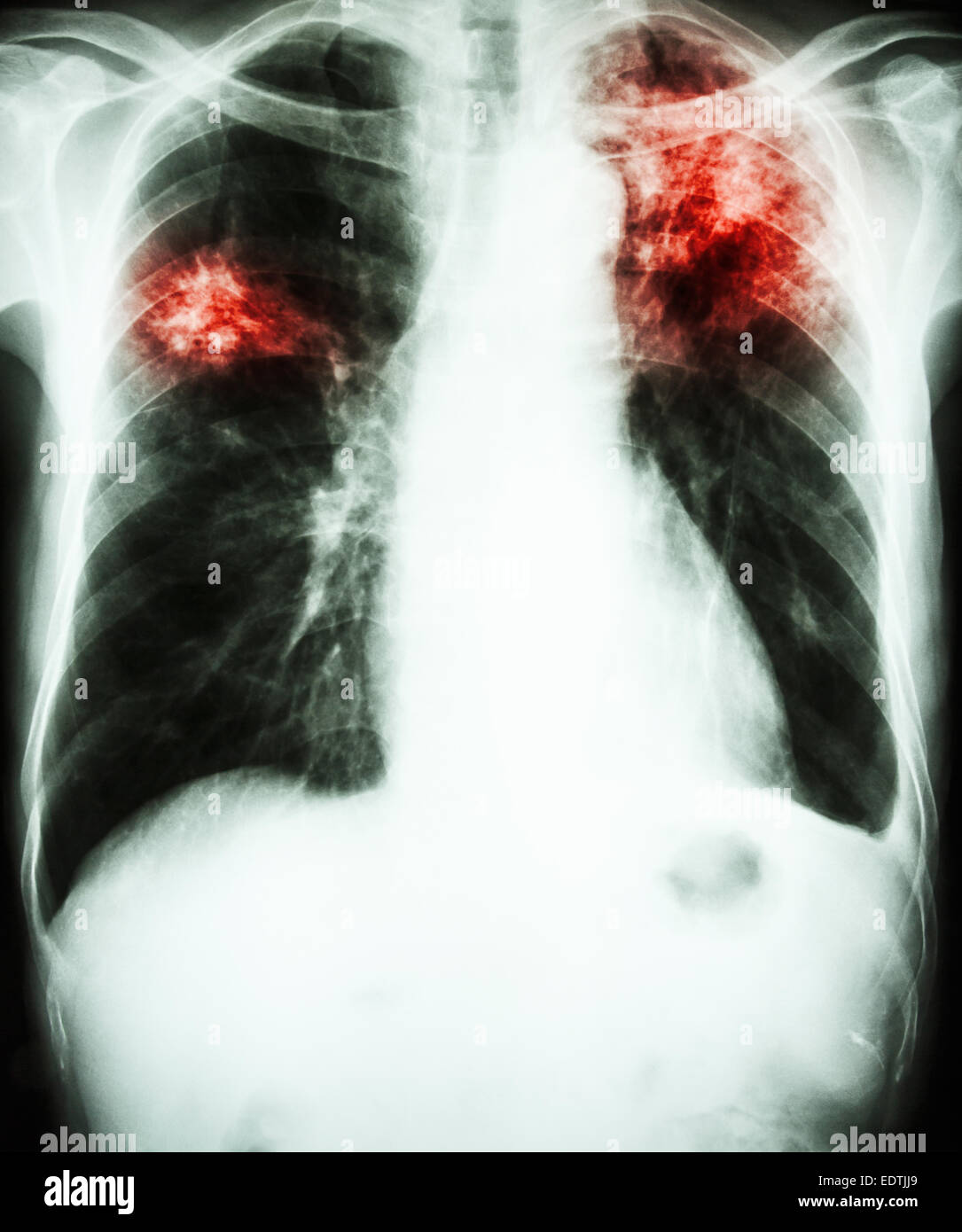 Pulmonary tuberculosis chest x ray interstitial hi-res stock ...
