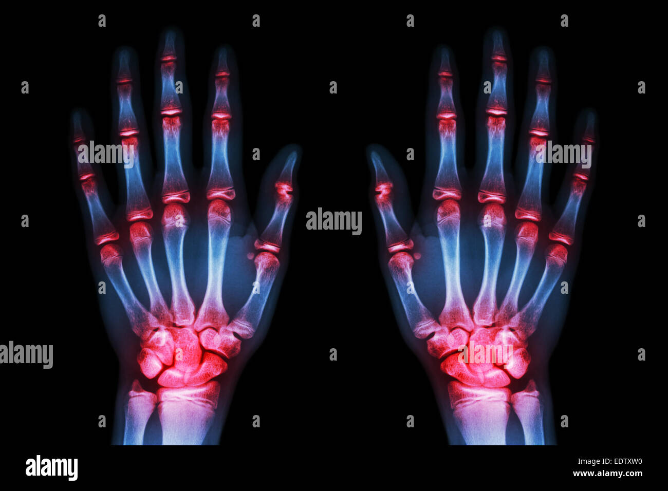 Rheumatoid arthritis hands x ray hi-res stock photography and images ...