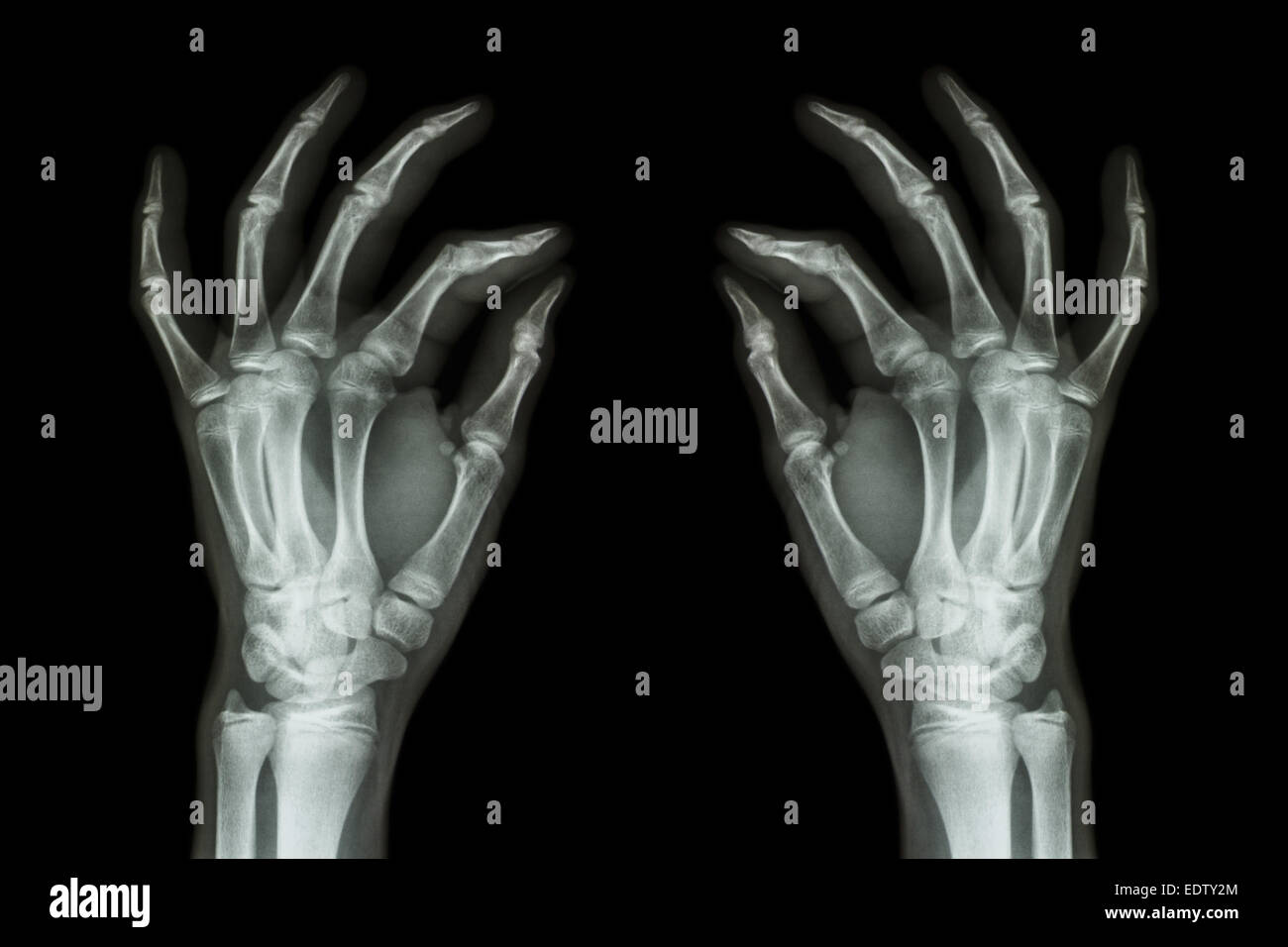 Xray hand normal hi-res stock photography and images - Alamy