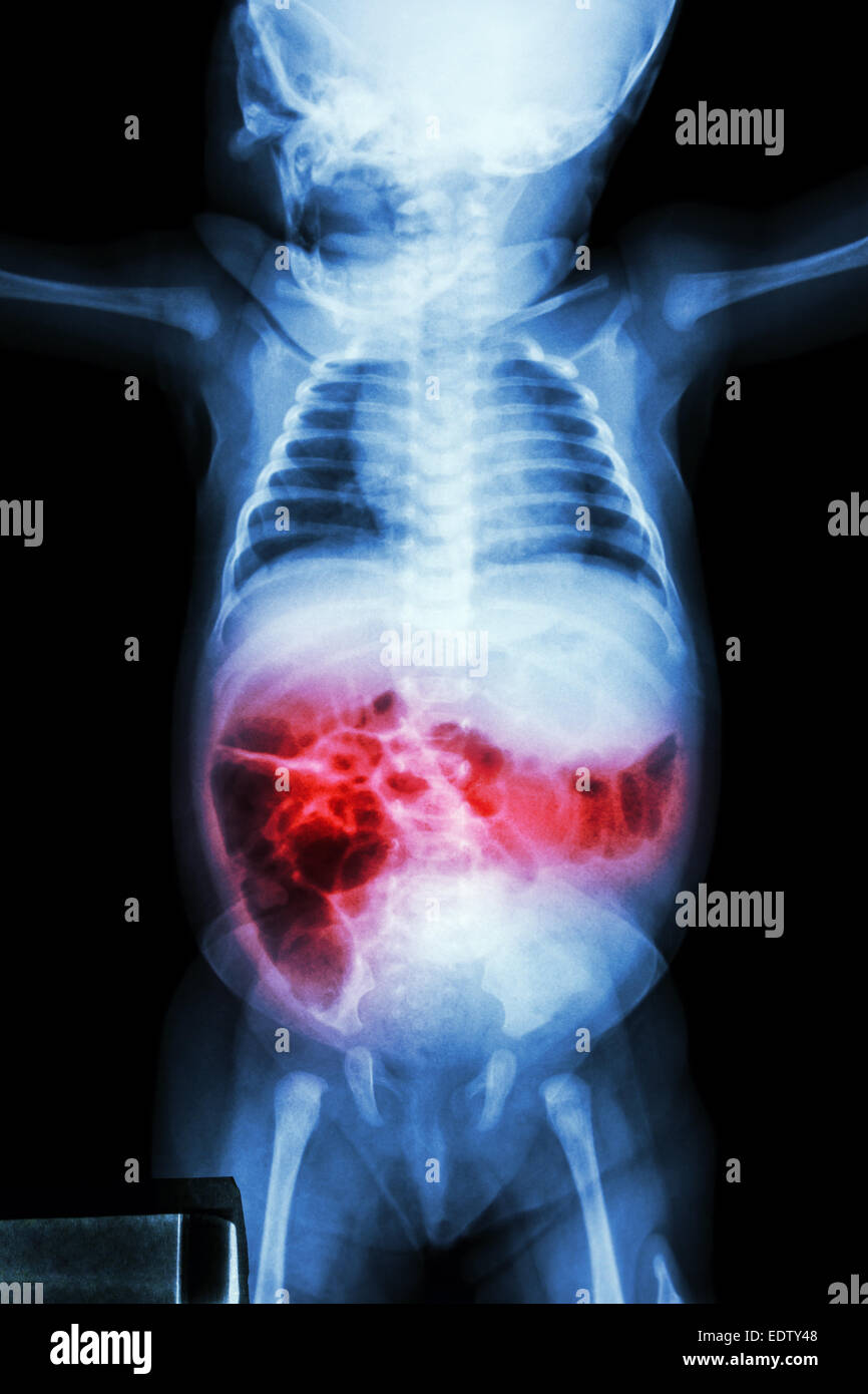 Enteritis (X-ray of sick infant and inflammation of intestine Stock ...