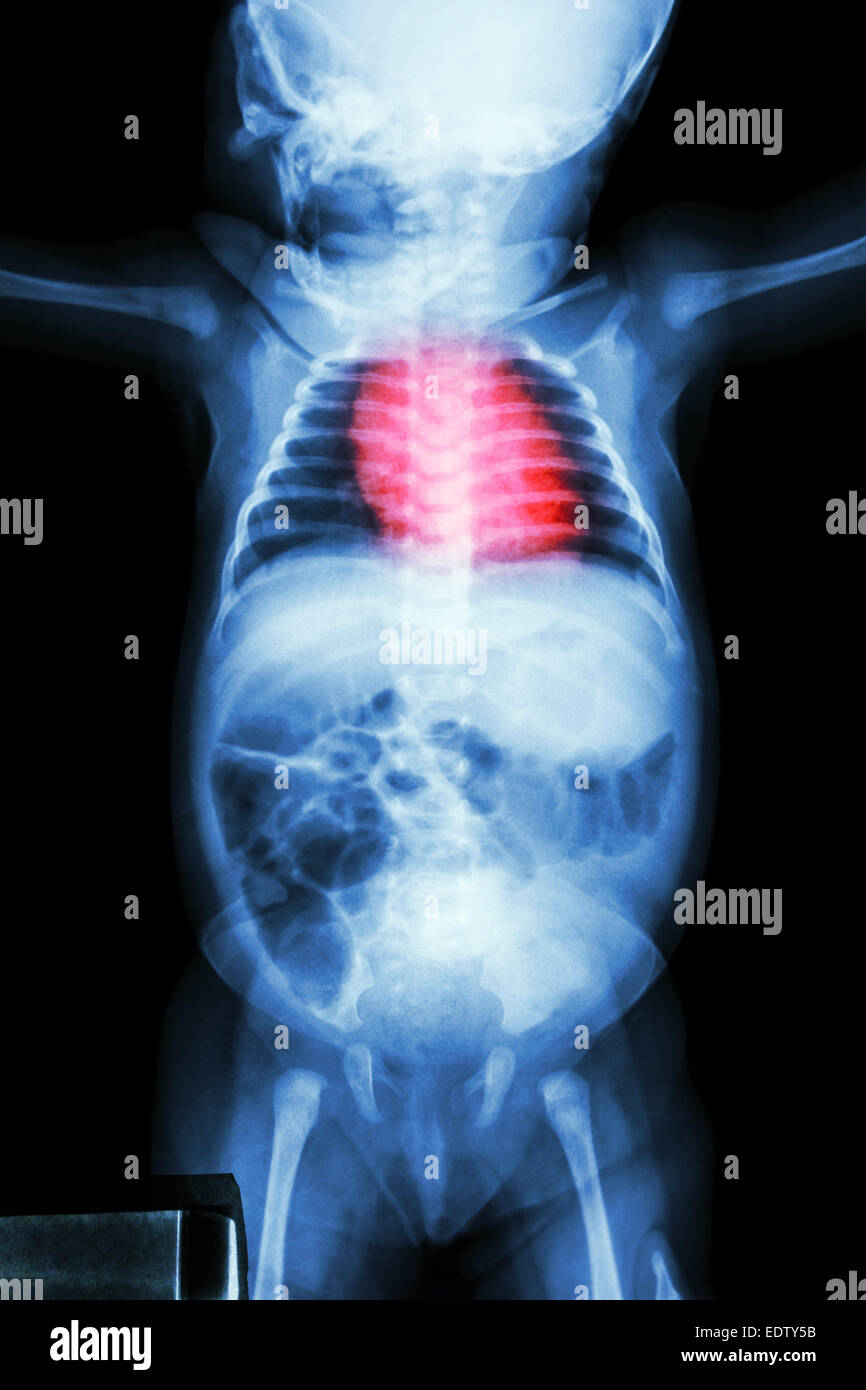 film x-ray whole infant's body : show normal infant's body Stock Photo ...