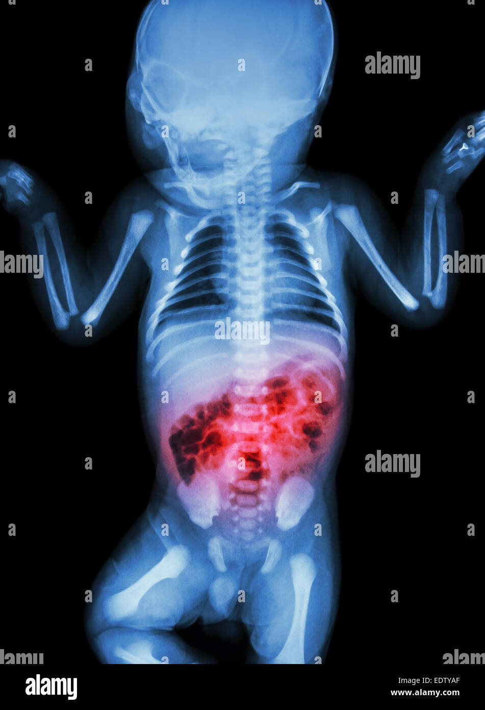 Enteritis gastrointestinal hi-res stock photography and images - Alamy