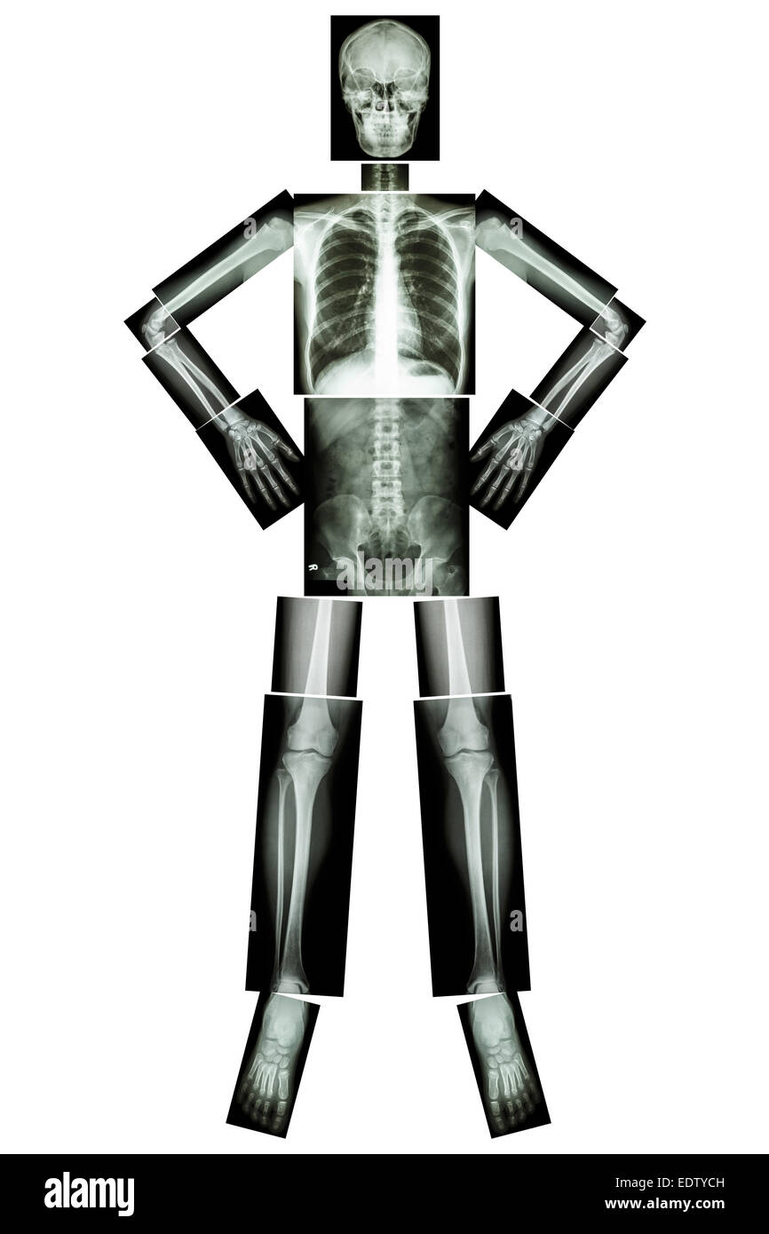 Human bone stand and akimbo (X-ray whole body : head skull neck spine ...