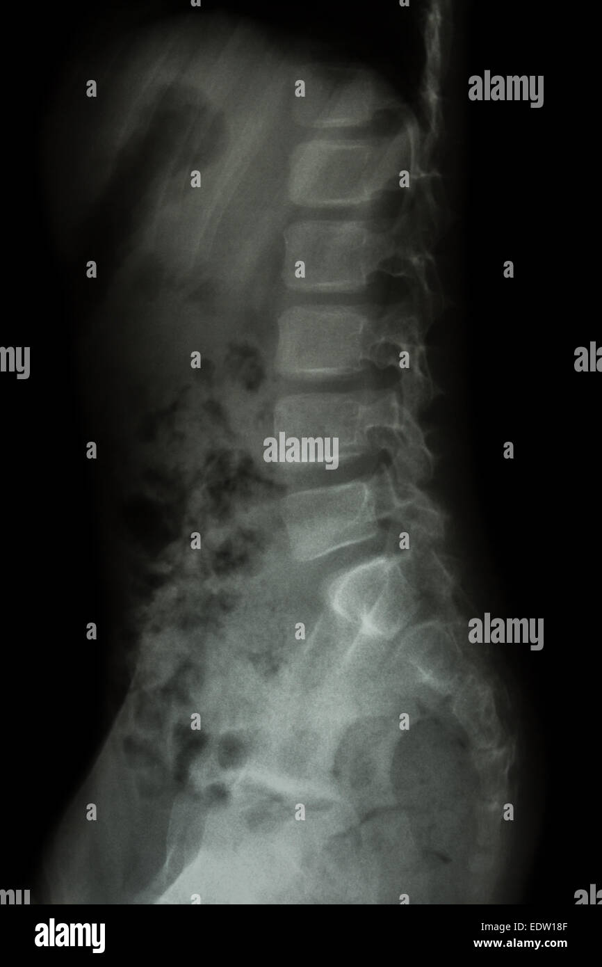 X ray normal lumbar spine hi-res stock photography and images - Alamy