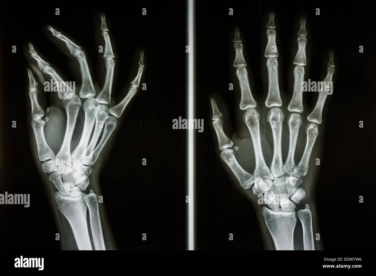X ray of palm hi-res stock photography and images - Alamy