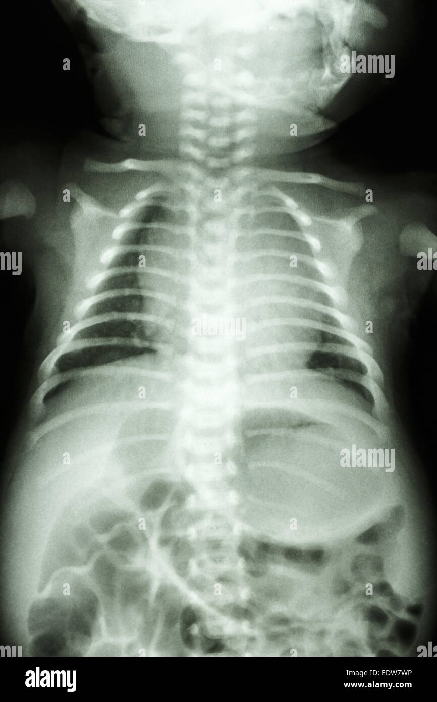 Infant Chest X Ray Normal At Annette Linda Blog