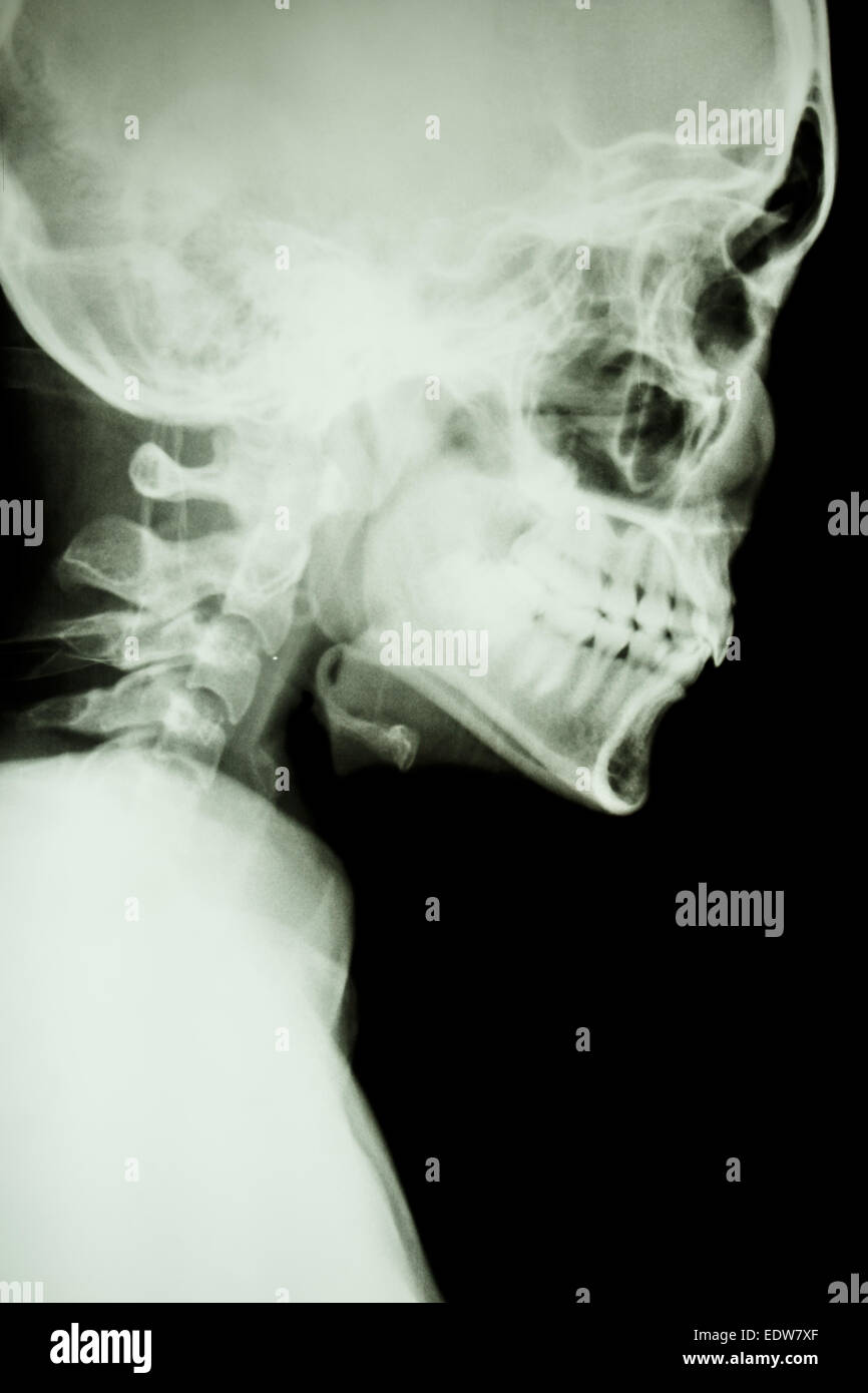 Normal neck x ray hi-res stock photography and images - Alamy