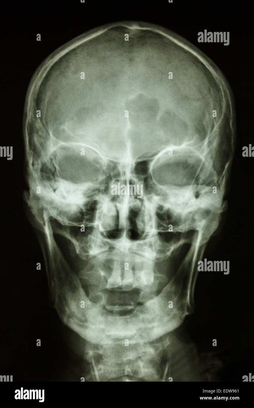 Normal Skull X Ray High Resolution Stock Photography and Images - Alamy