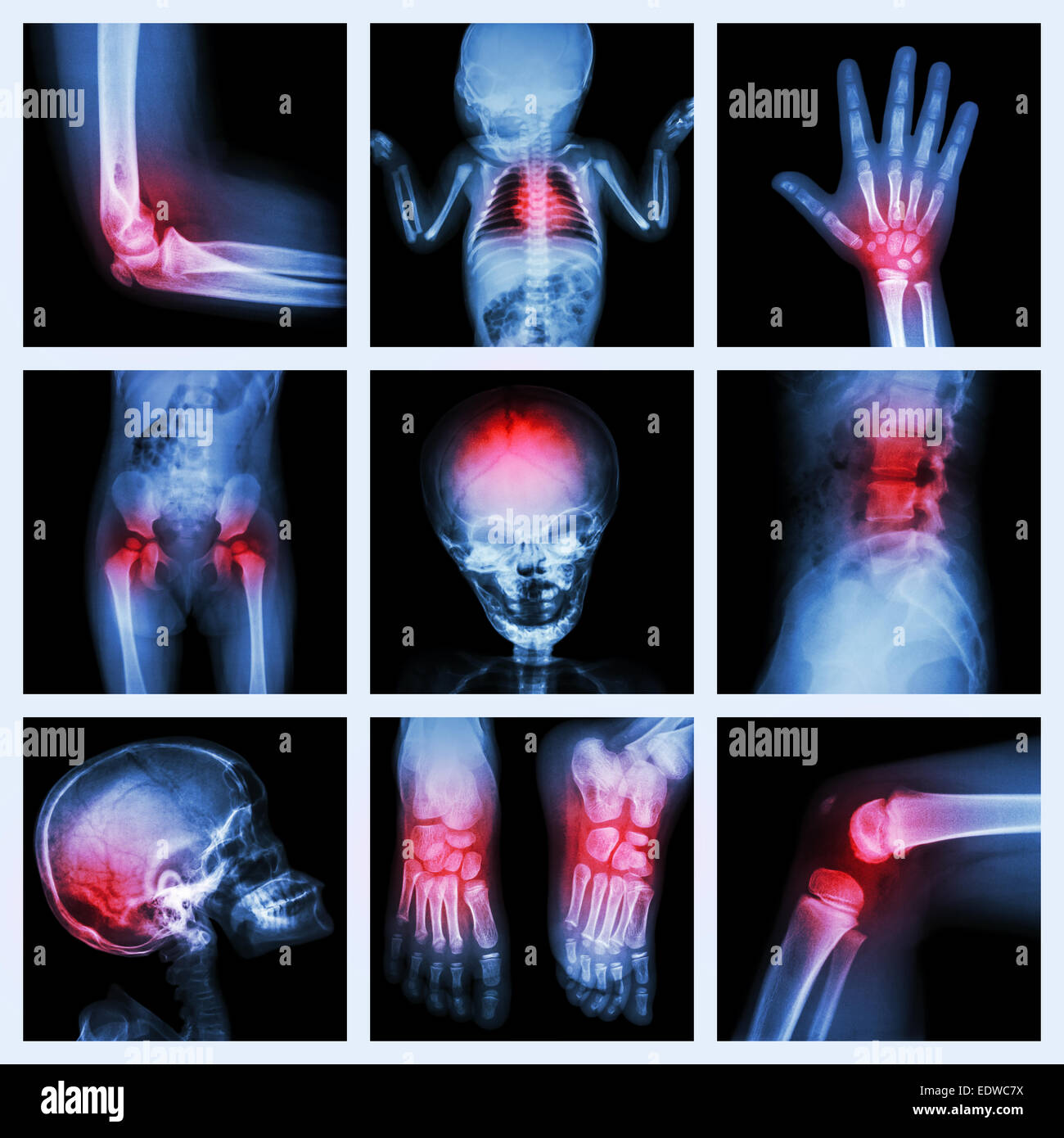 Child pelvis x ray hi-res stock photography and images - Alamy