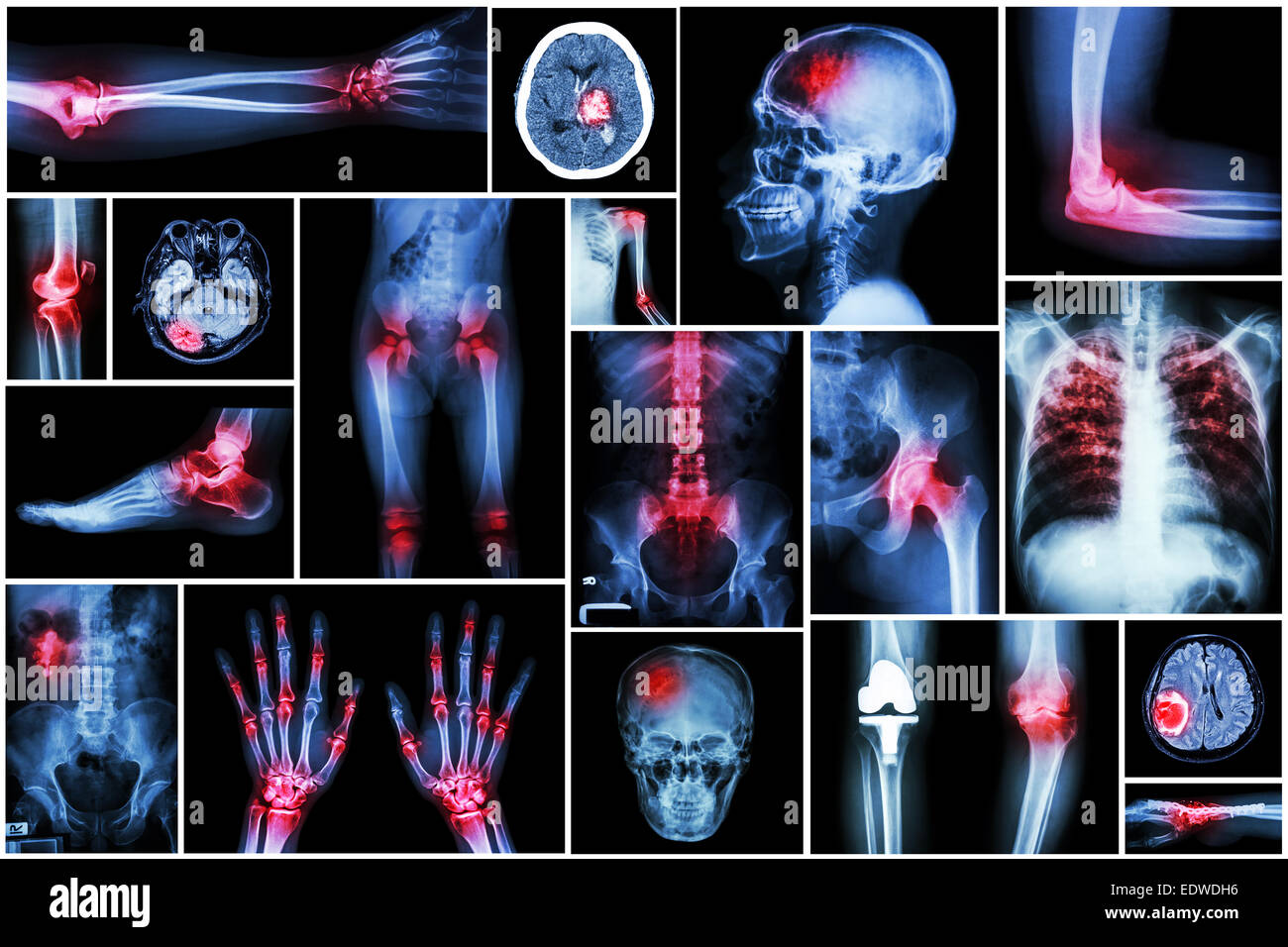 Arthritis hip x ray hi-res stock photography and images - Alamy