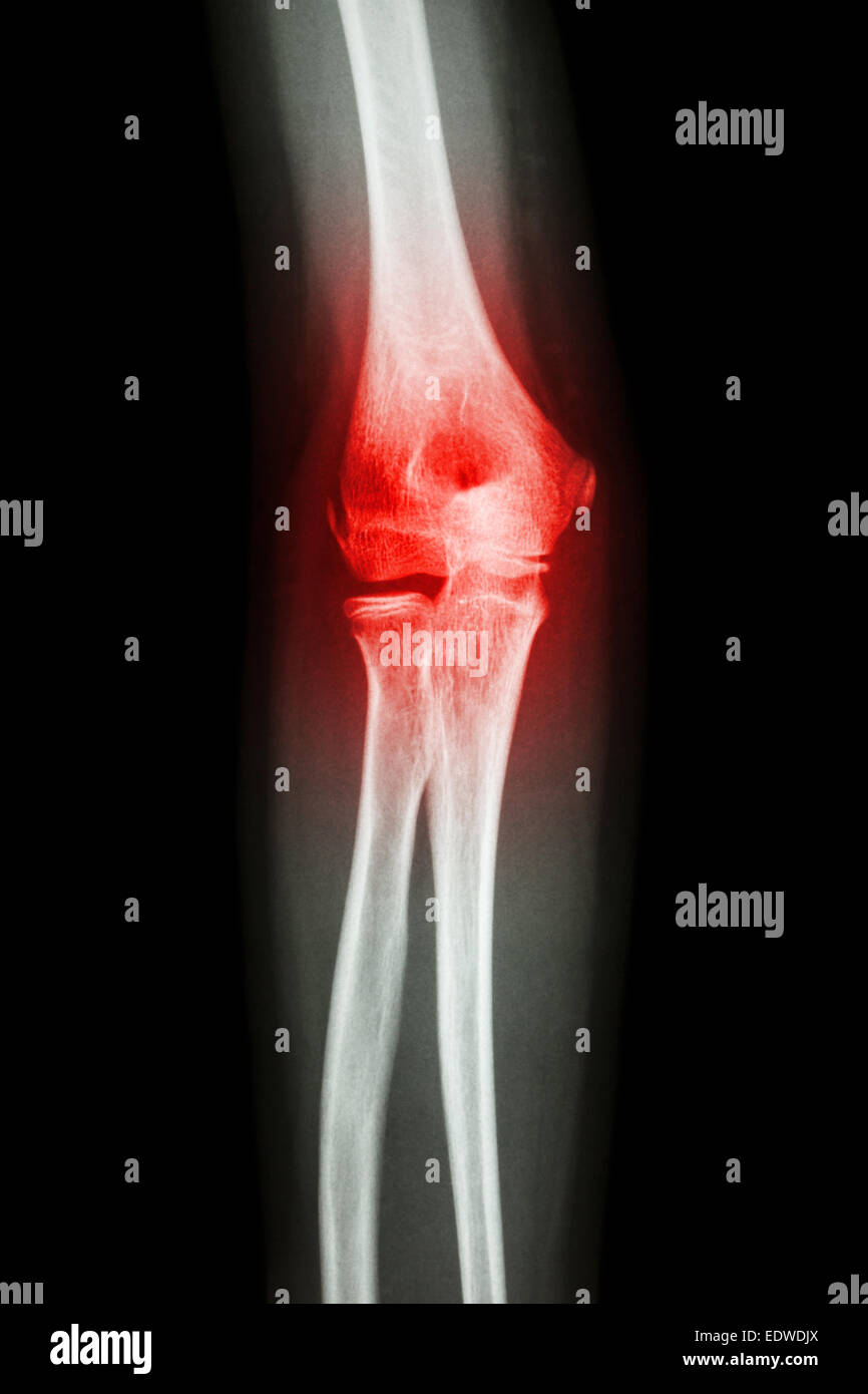 Gout structure hi-res stock photography and images - Alamy