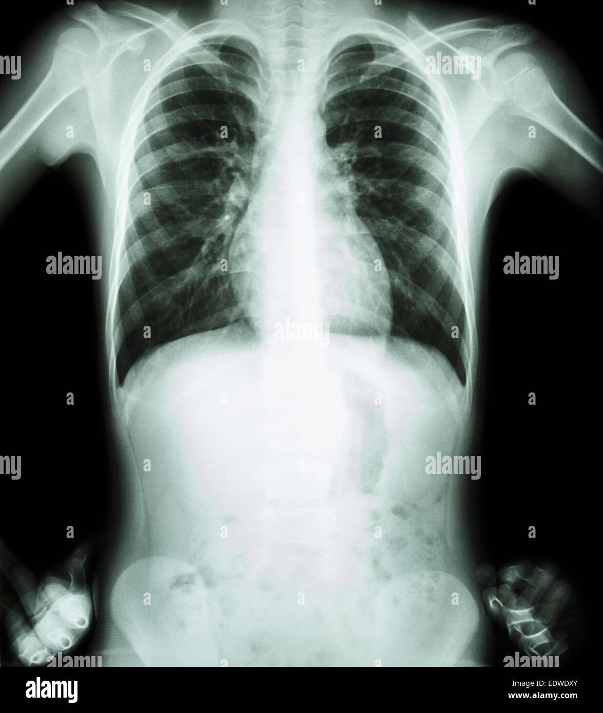 X-ray chest ( akimbo position ) ( front view Stock Photo - Alamy