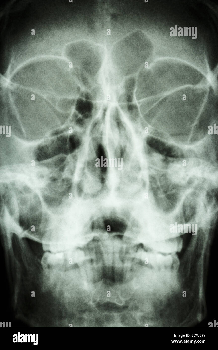 close up of asian's skull(Thai people) . Can seen structure of skull ...