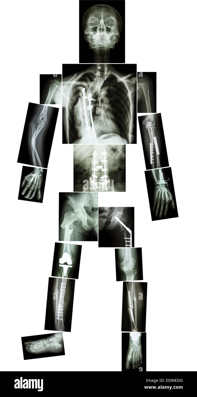 skeleton of human and multiple fracture. he was operated and internal ...