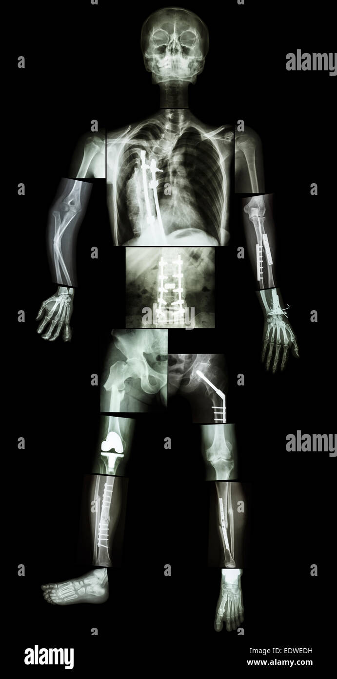 skeleton of human and multiple fracture. he was operated and internal ...