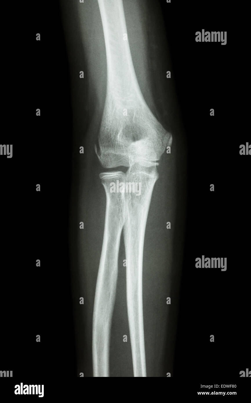 Normal anatomy of the elbow hi-res stock photography and images - Alamy