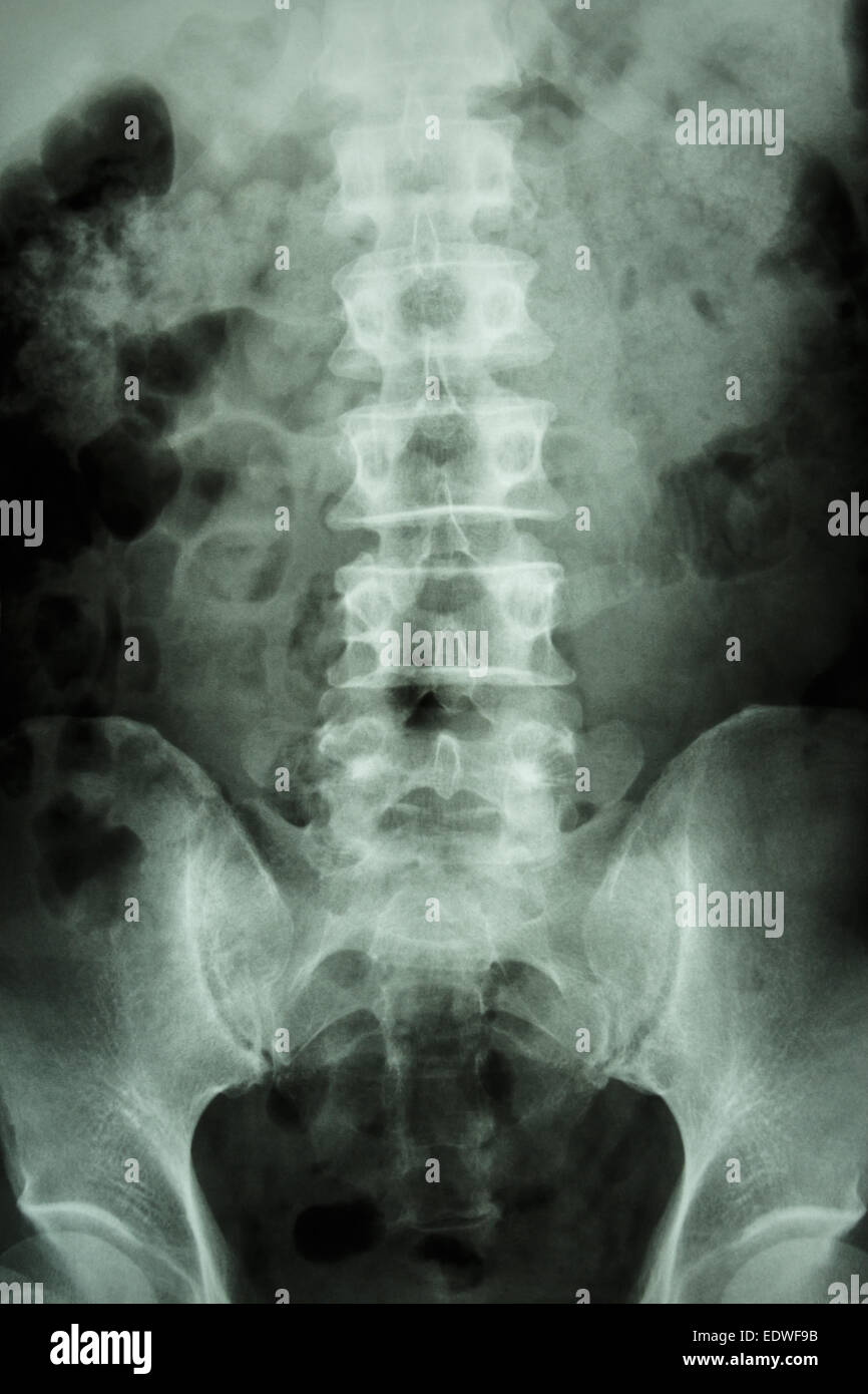 film x-ray L-S spine (lumbar-sacrum) : show normal human lumbar-sacrum ...
