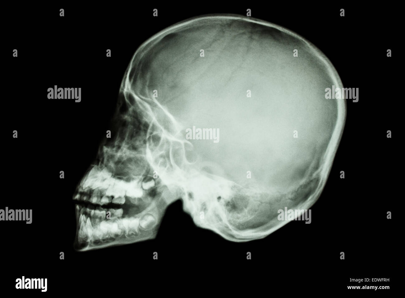 Infant skull hi-res stock photography and images - Alamy
