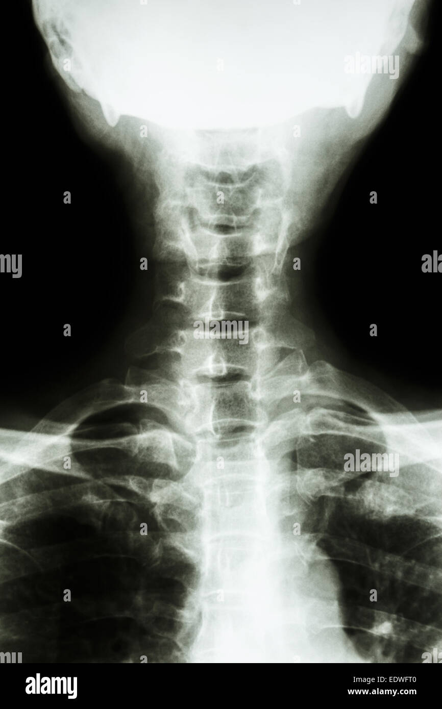 Normal neck x ray hi-res stock photography and images - Alamy