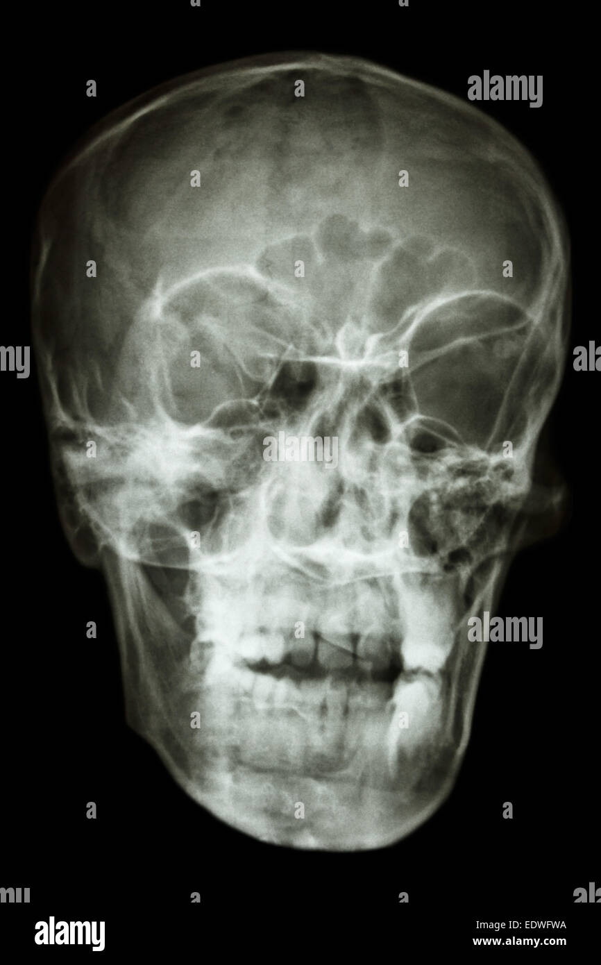 X Ray Skull Anatomy