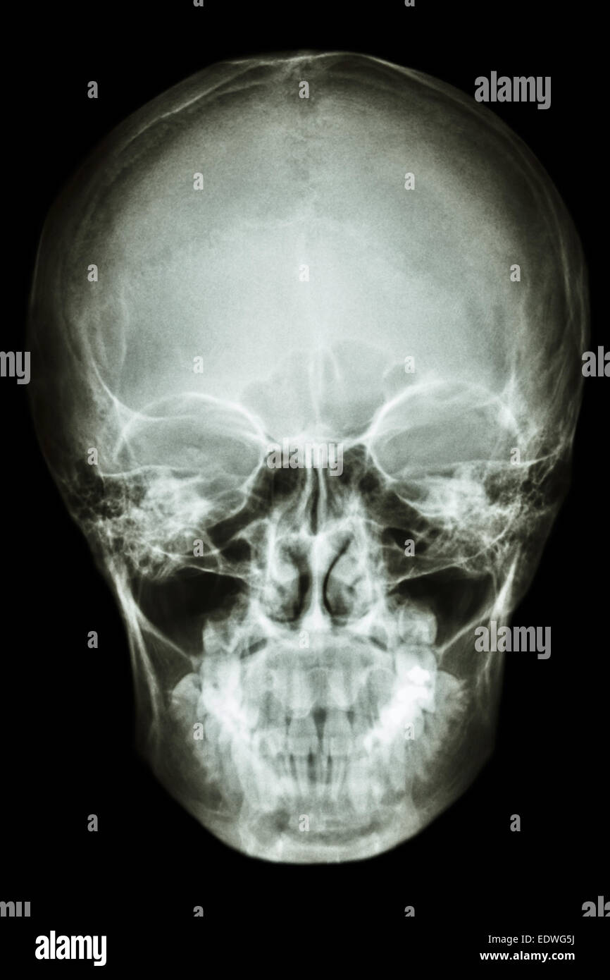 film x-ray asian people's skull (Thai people Stock Photo - Alamy