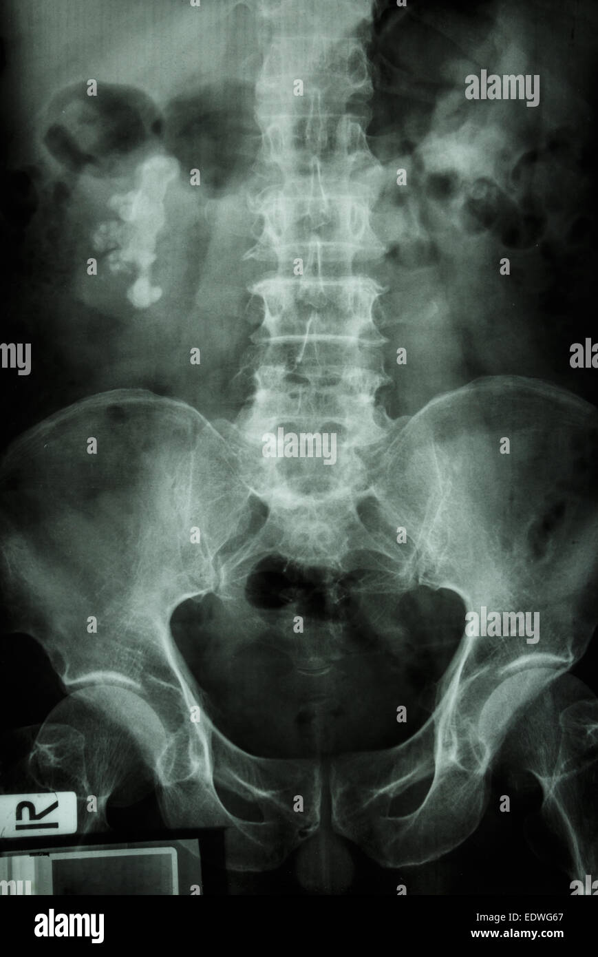 film x-ray show right renal calculi (staghorn Stock Photo - Alamy