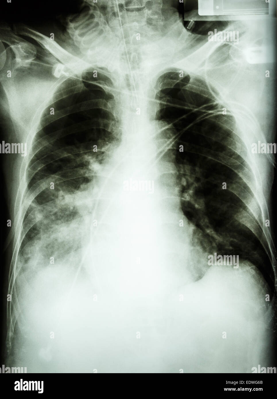 "Pneumonia with respiratory failure" film chest x-ray of patient with ...
