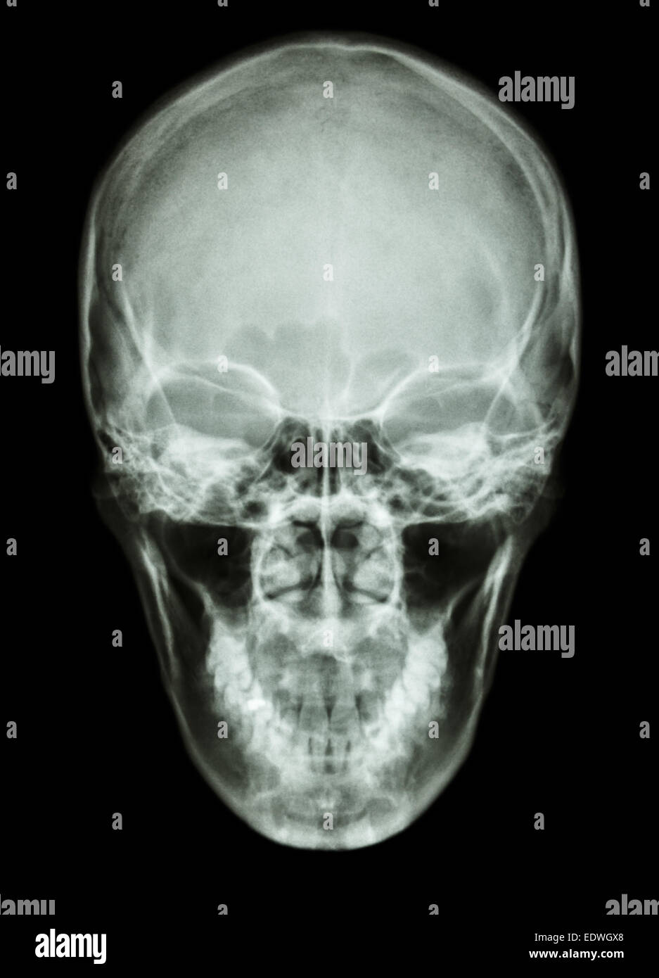 Front Skull X Ray Image High Resolution Stock Photography and Images ...
