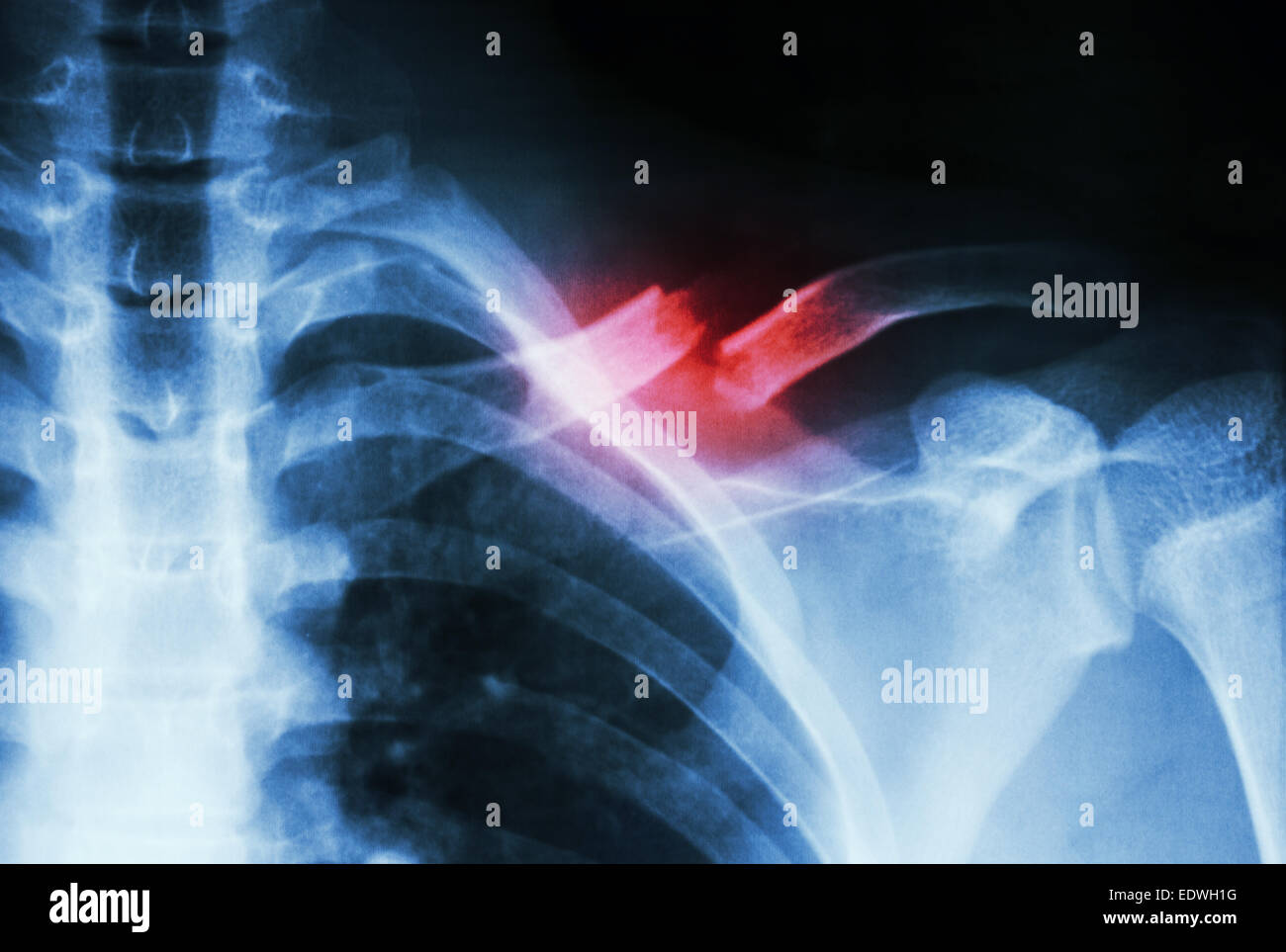 Rib fracture hi-res stock photography and images - Alamy