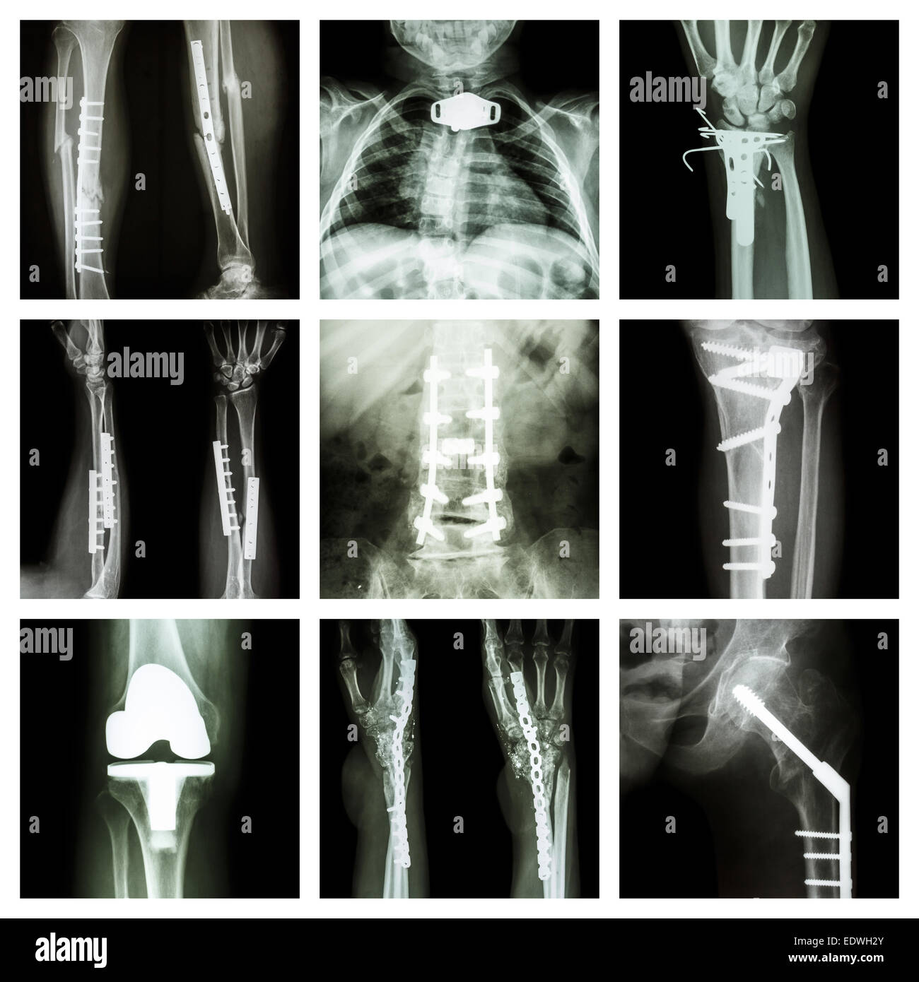 Collection of orthopedic operation Stock Photo - Alamy