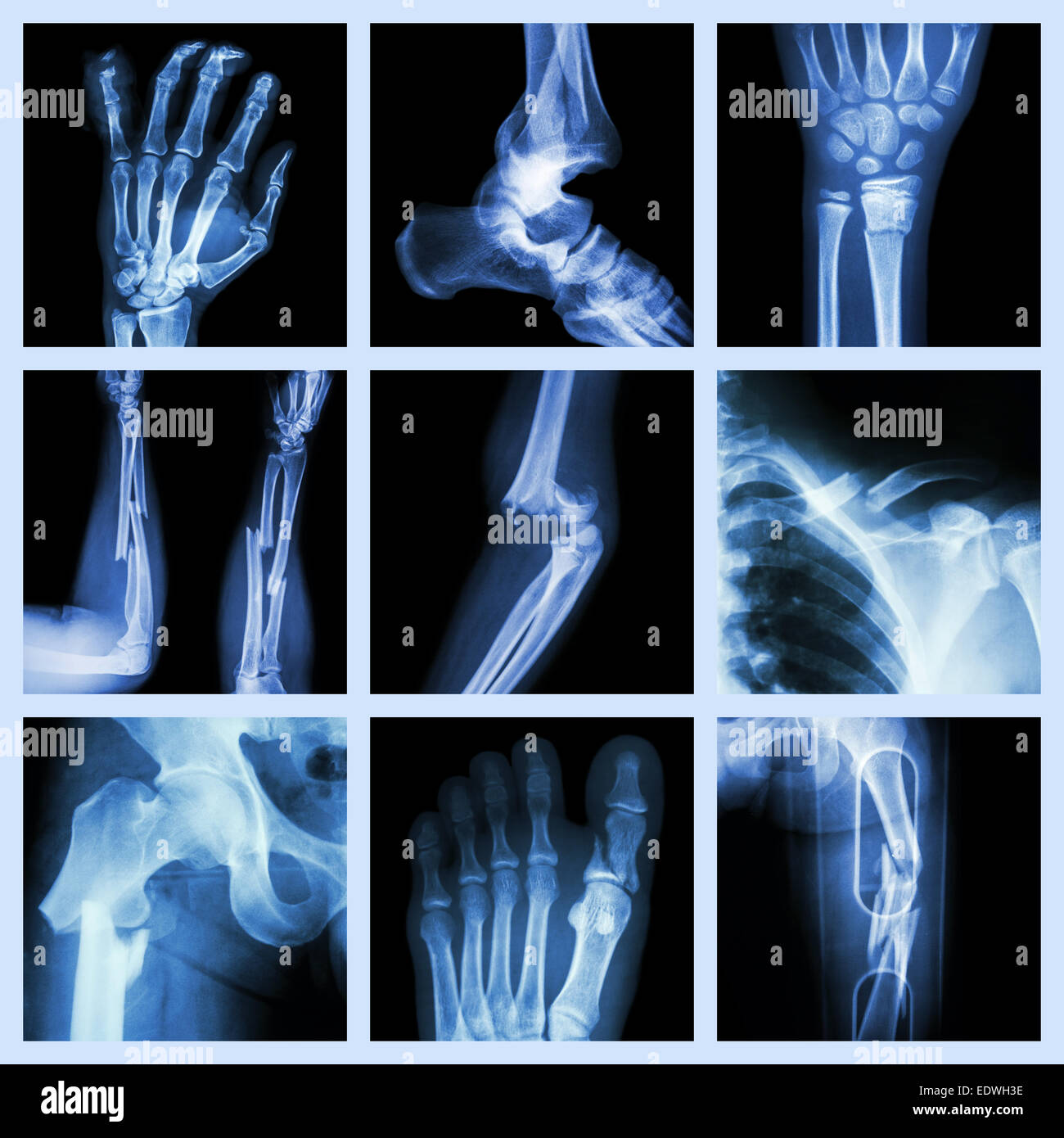 Fracture hi-res stock photography and images - Alamy