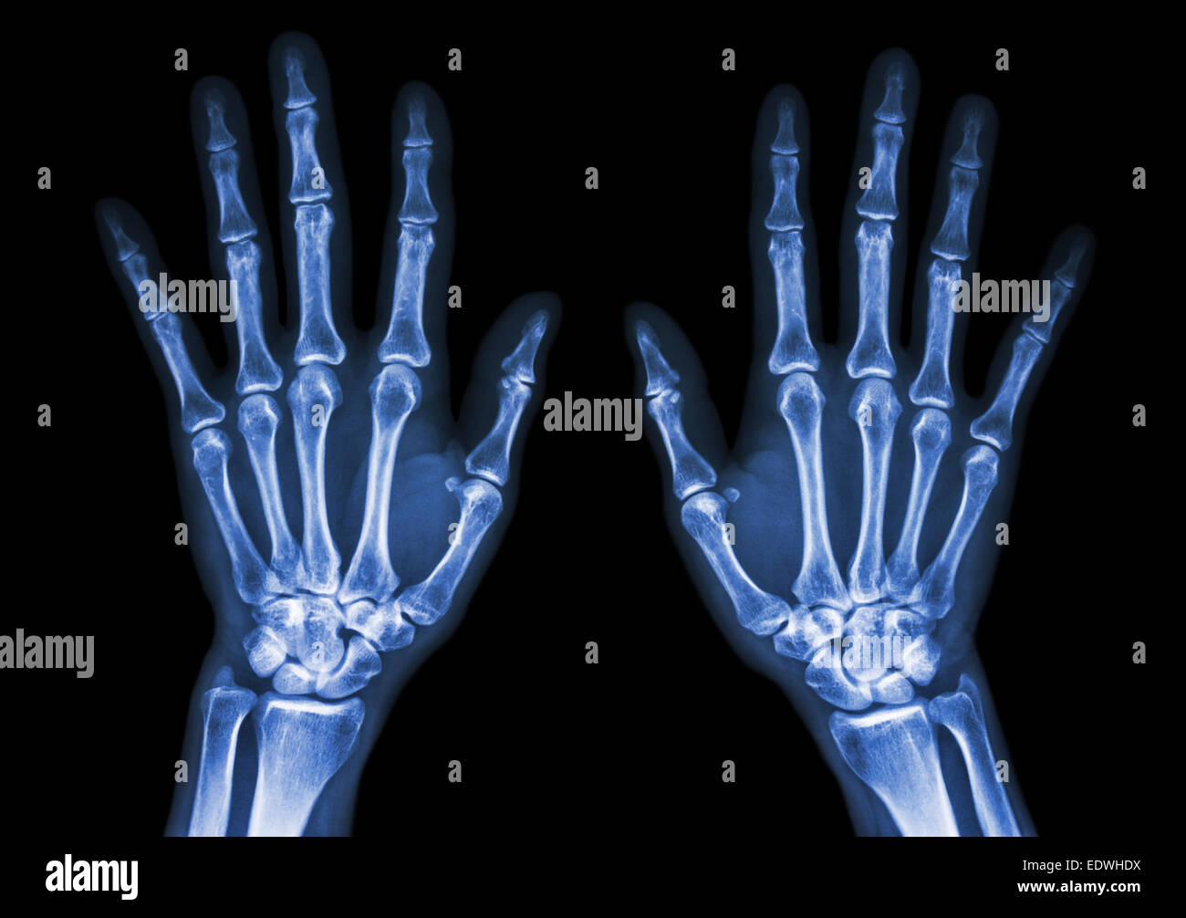 film x-ray both hand AP : show normal human's hands on black background ...