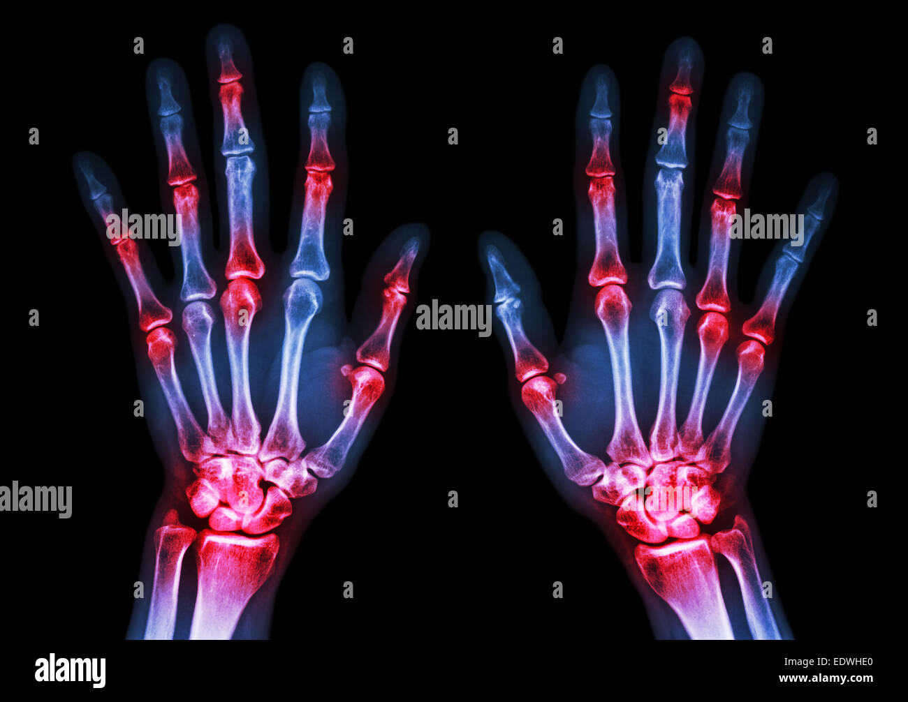 Rheumatoid Arthritis Hands