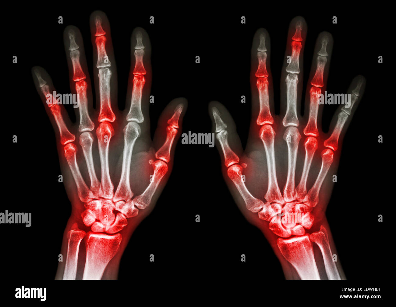 X Ray Normal Hand High Resolution Stock Photography and Images - Alamy