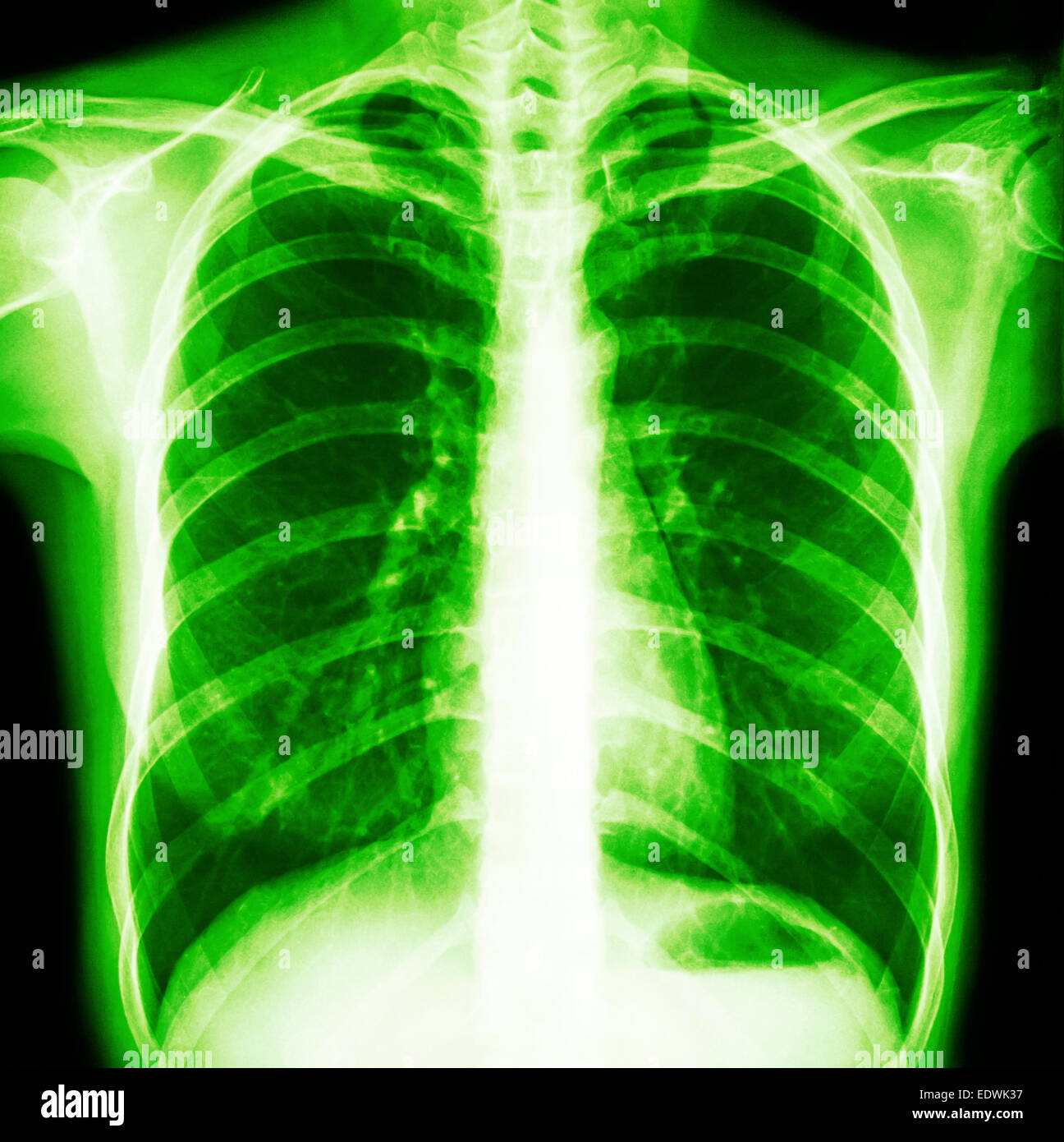 Film chest x-ray PA upright : show normal human's chest Stock Photo - Alamy