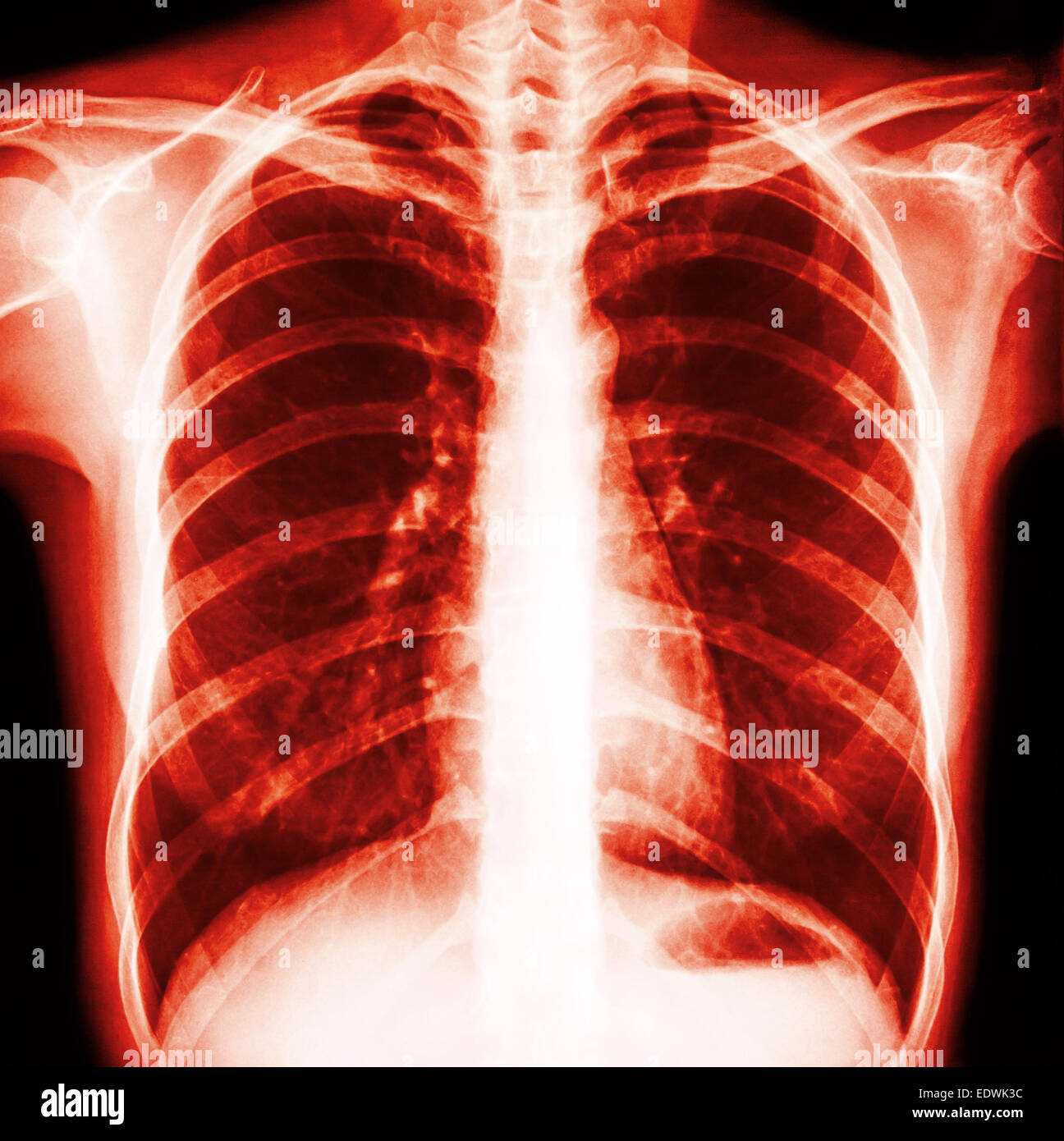 Film chest x-ray PA upright : show normal human's chest Stock Photo - Alamy