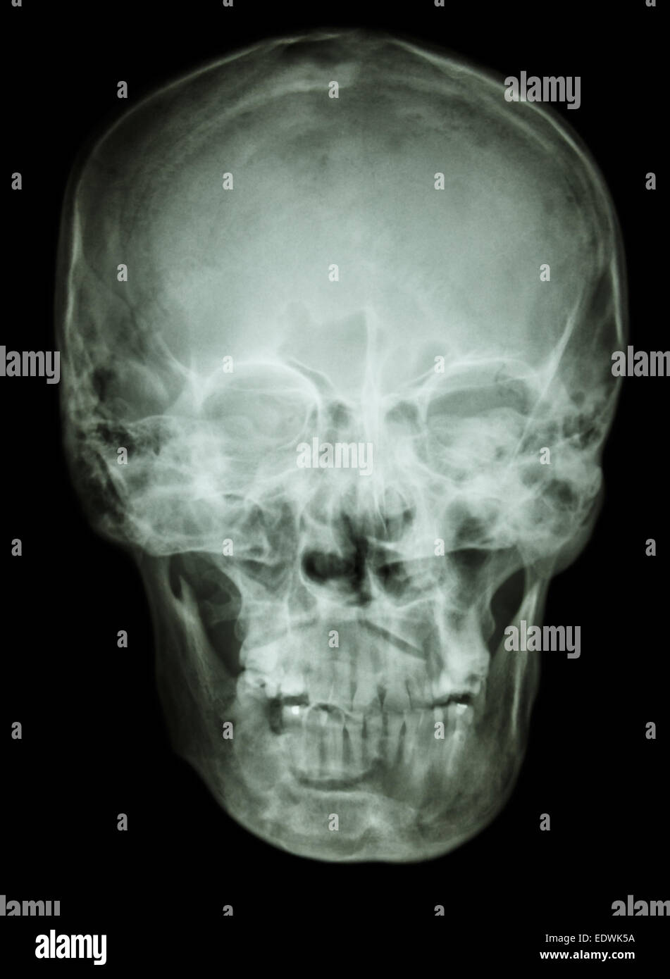 Normal Skull X Ray High Resolution Stock Photography and Images - Alamy