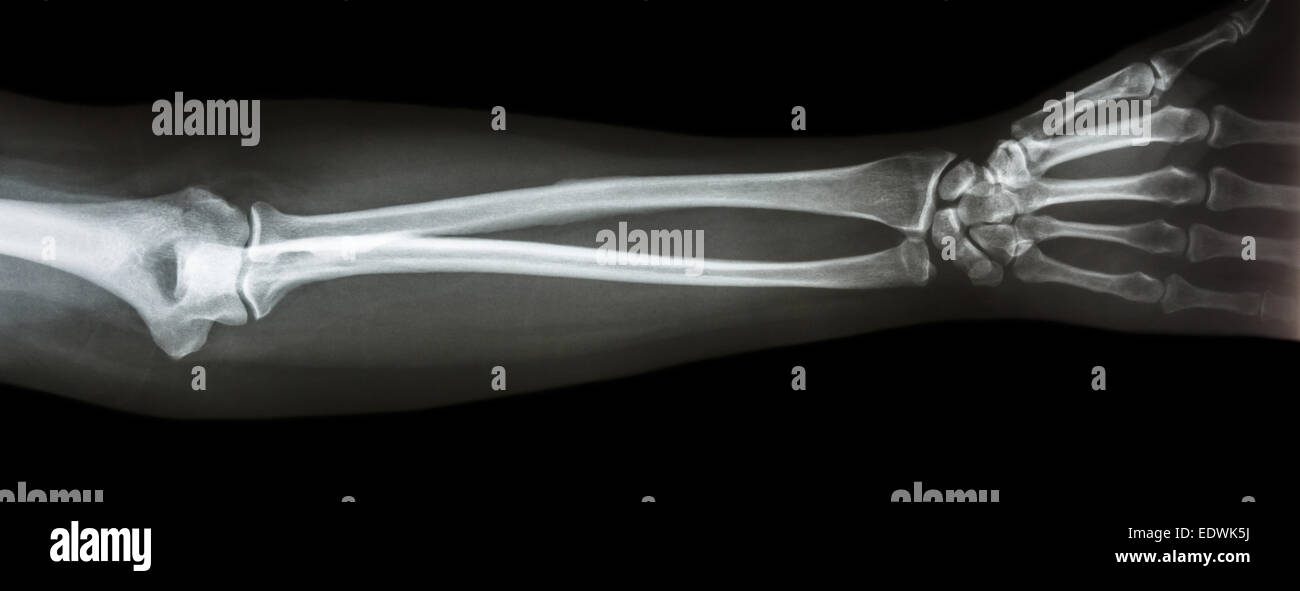 X Ray Normal Hand High Resolution Stock Photography and Images - Alamy
