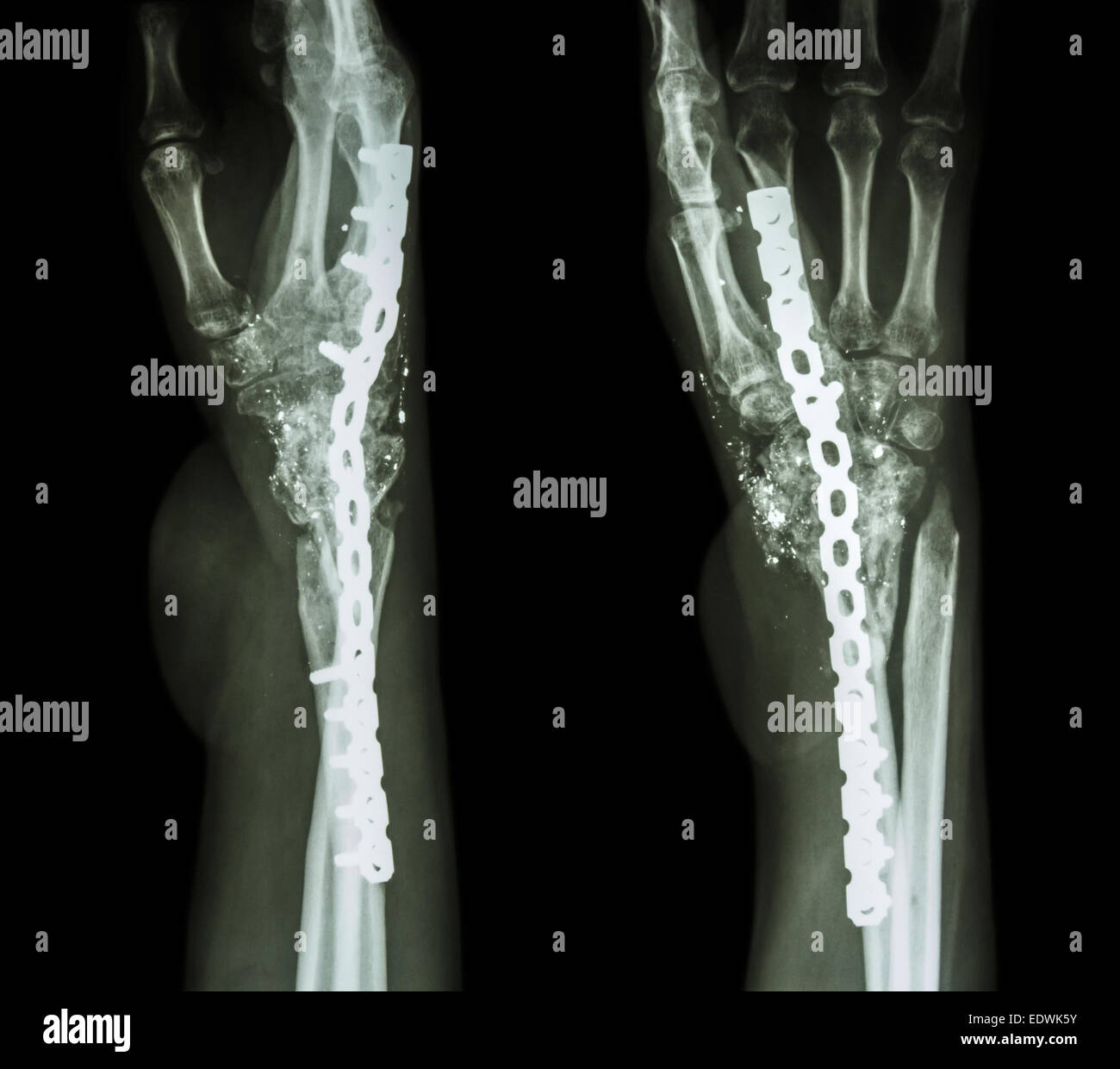 Fracture wrist and chronic infection. It was operated and internal ...
