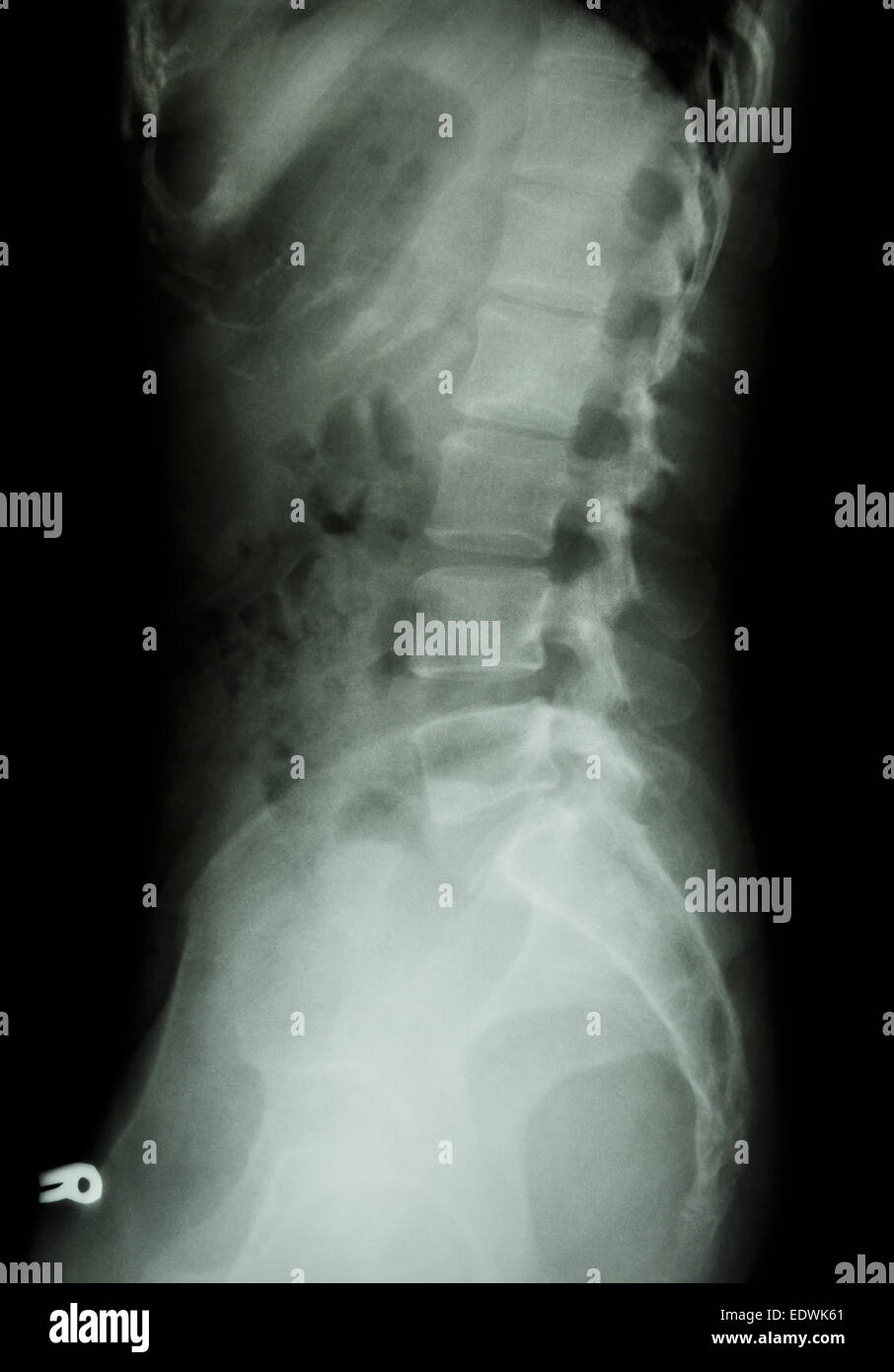 X-ray lumbo-sacral spine (lateral) of asian adult people Stock Photo ...