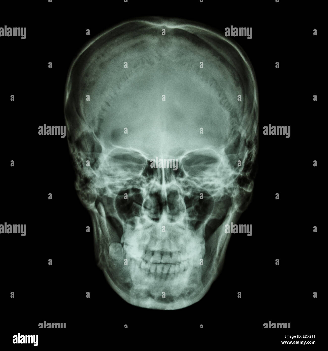 Normal Skull X Ray High Resolution Stock Photography and Images - Alamy
