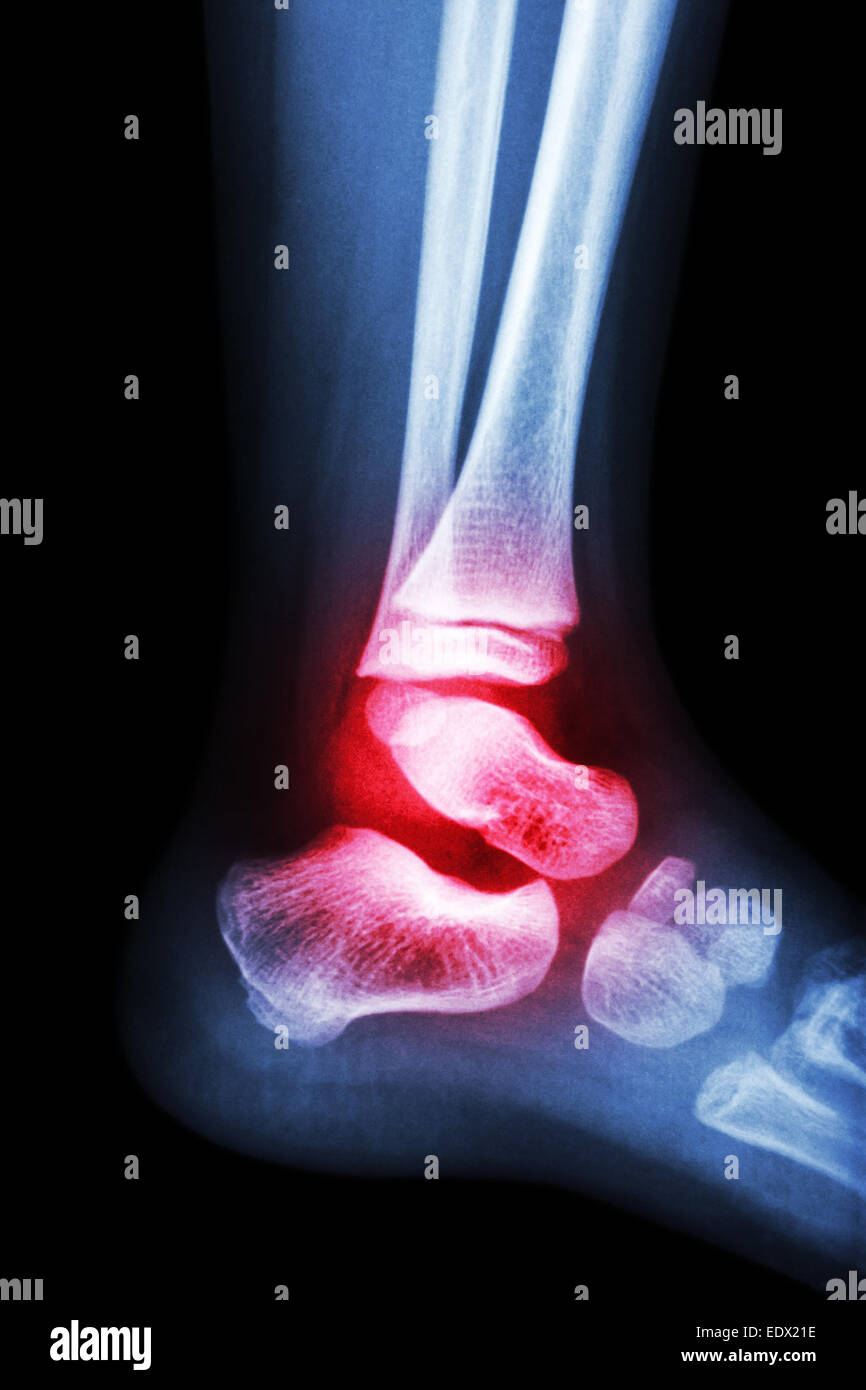 Film x-ray child's ankle and arthritis at ankle (Rheumatoid Stock Photo ...