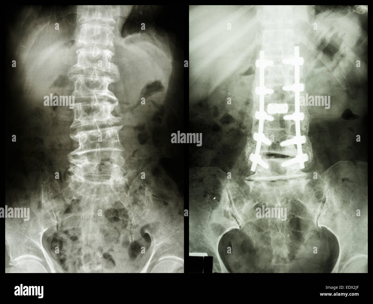 Spondylosis hi-res stock photography and images - Alamy