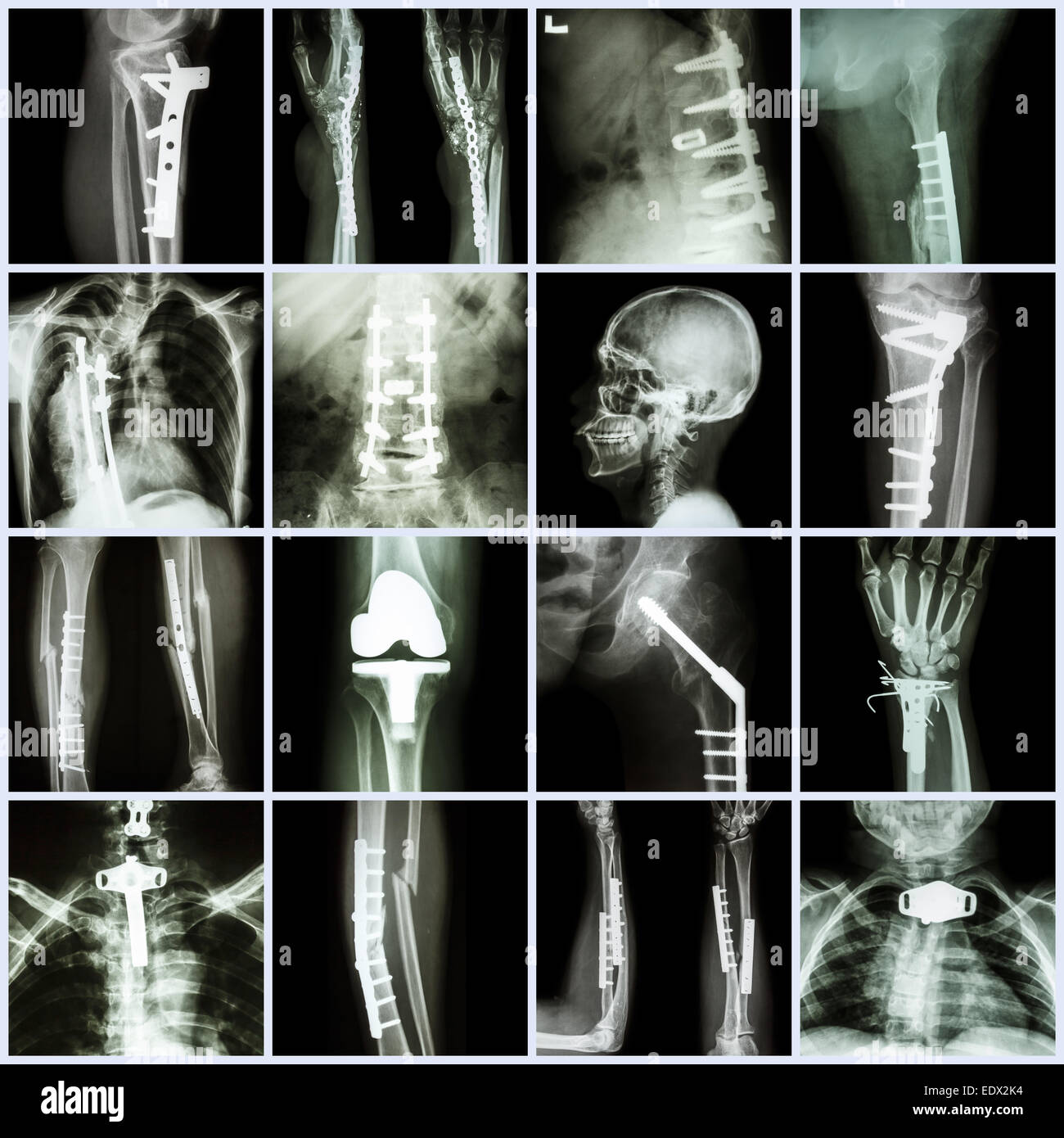 Orthopedic surgery hi-res stock photography and images - Alamy