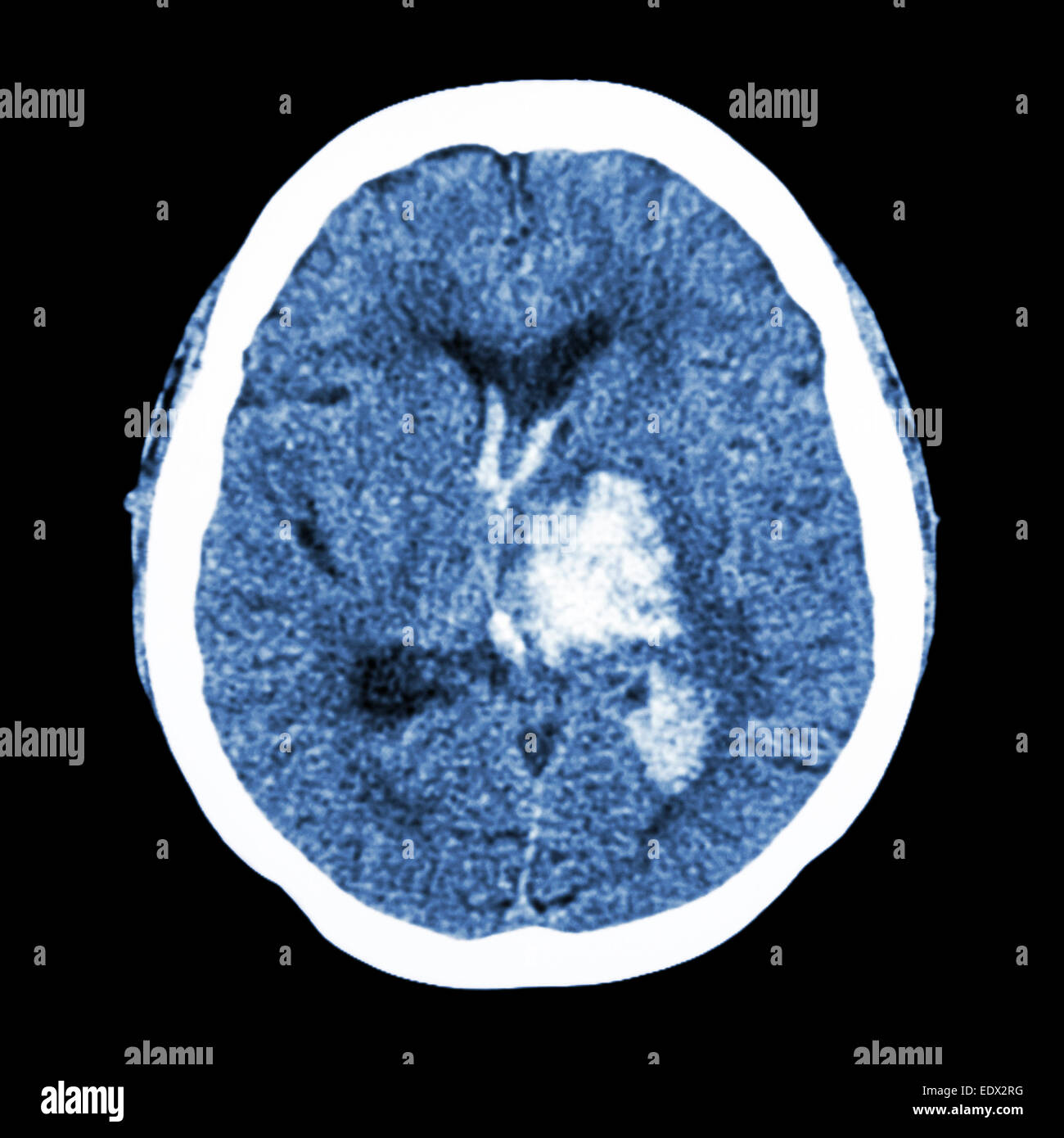 CT brain : show left thalamic hemorrhage (Hemorrhagic stroke Stock ...